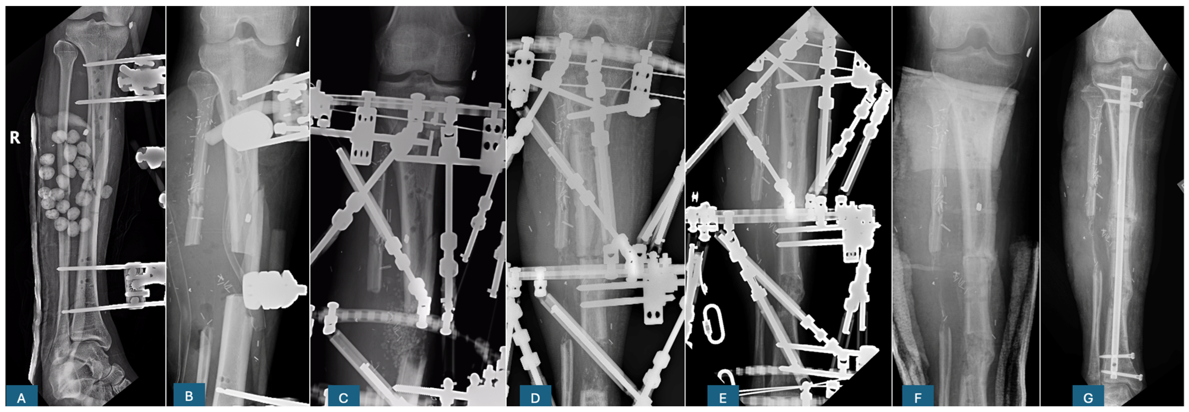 A Comprehensive Review of Bone Remodeling After Trauma and Operative ...