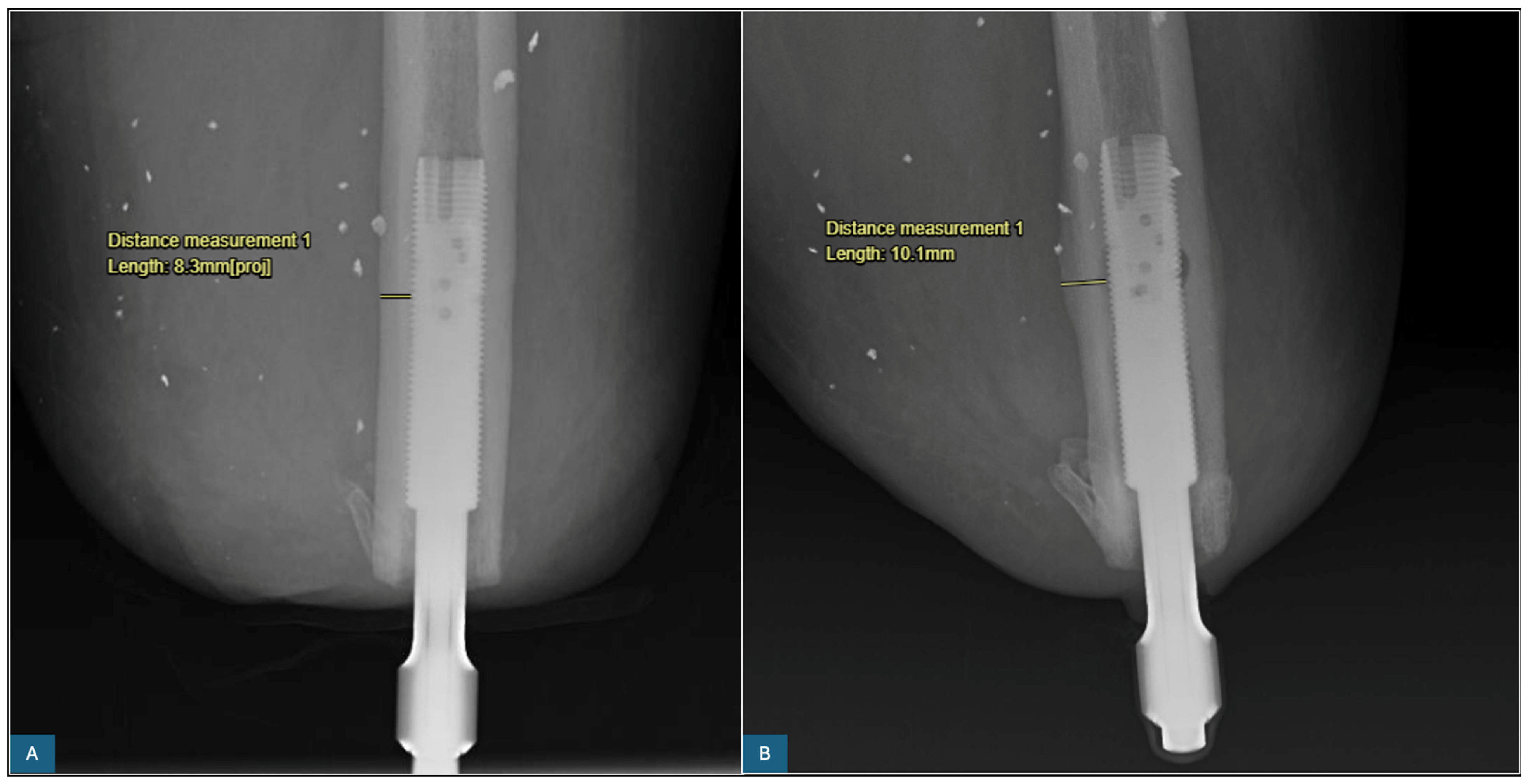 A Comprehensive Review of Bone Remodeling After Trauma and Operative ...