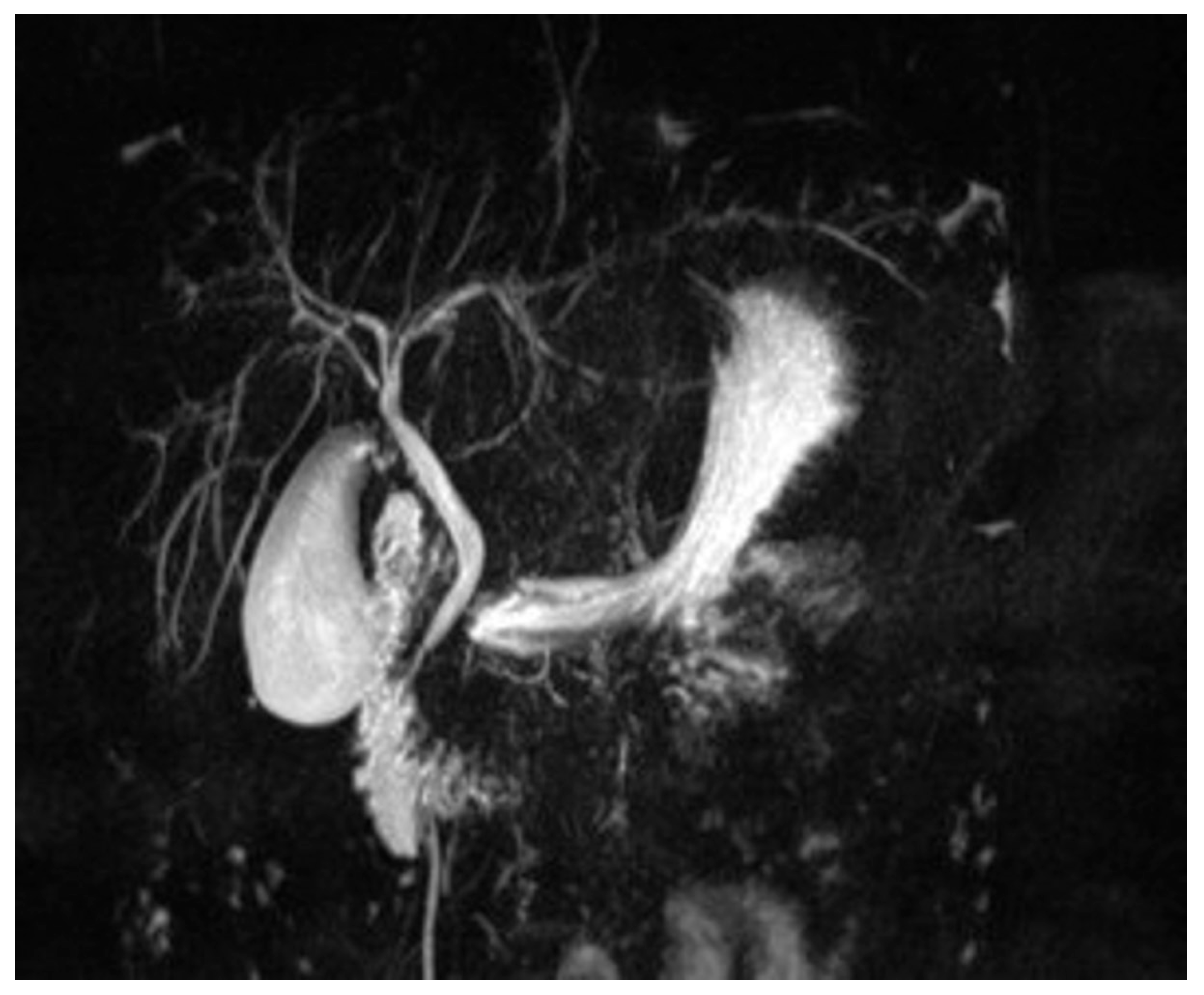 Pediatric Autoimmune Sclerosing Cholangitis: Diagnostic and Therapeutic ...