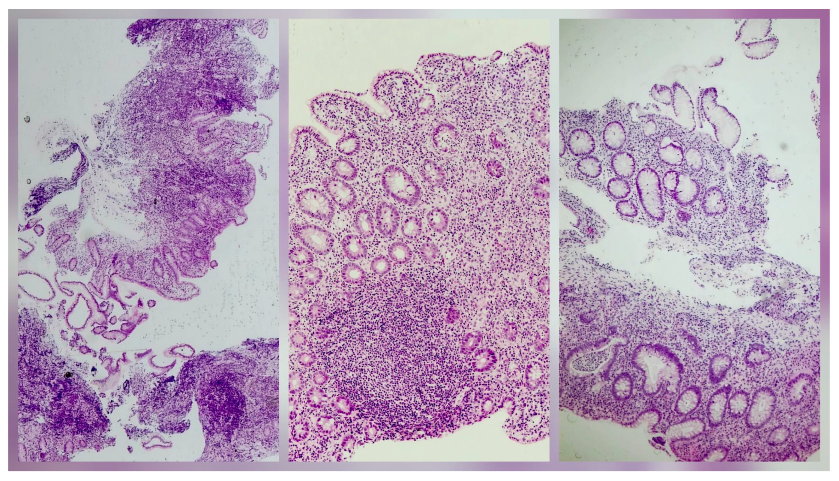 Pediatric Autoimmune Sclerosing Cholangitis: Diagnostic and Therapeutic ...