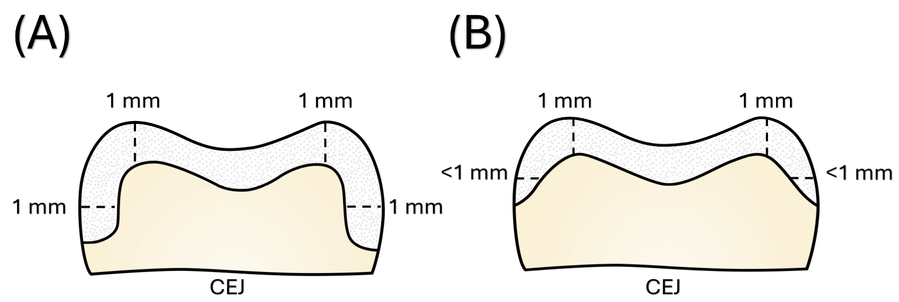 Effect of Tooth Preparation Design on Fracture Resistance and Marginal ...