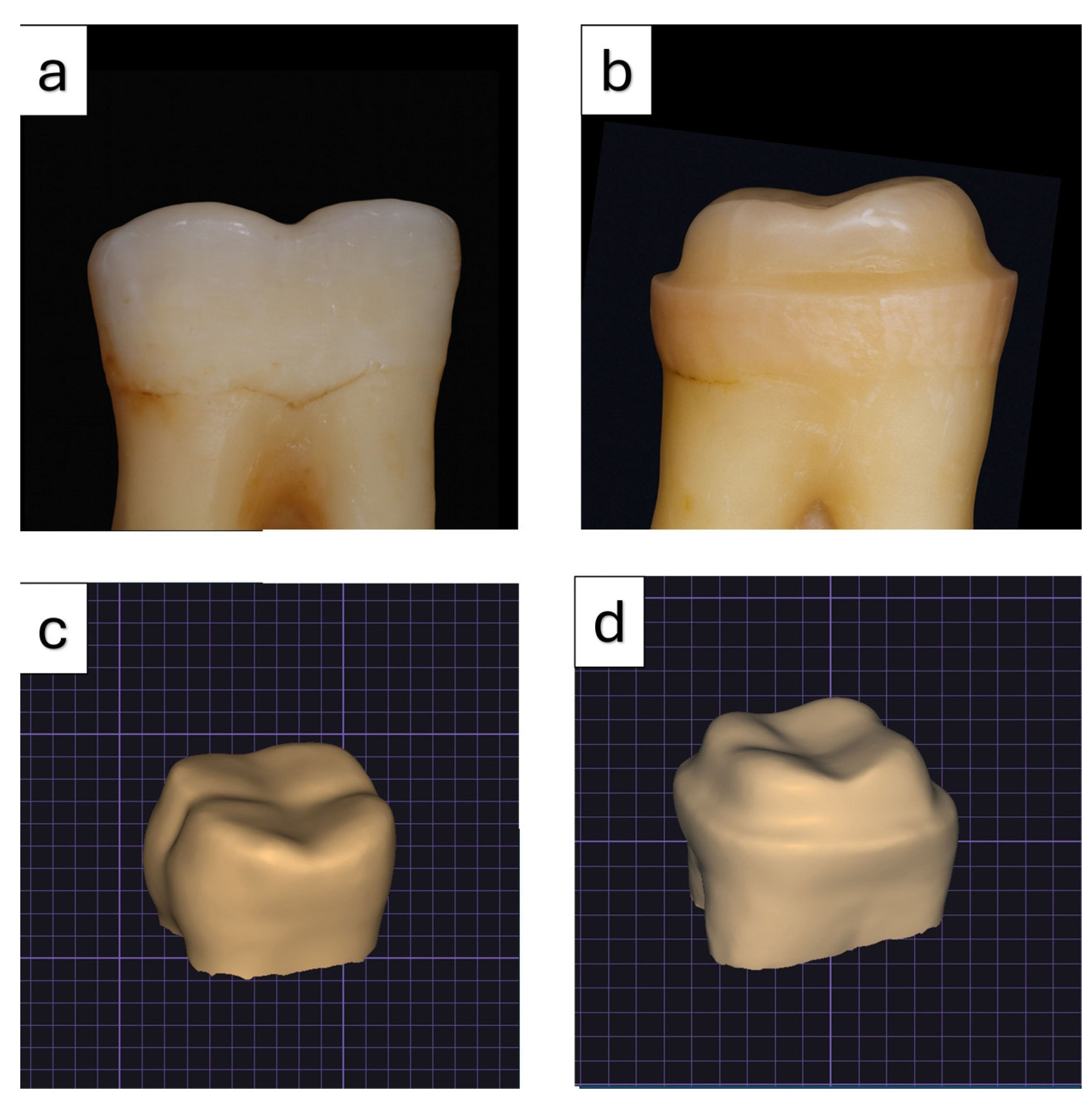 Effect of Tooth Preparation Design on Fracture Resistance and Marginal ...
