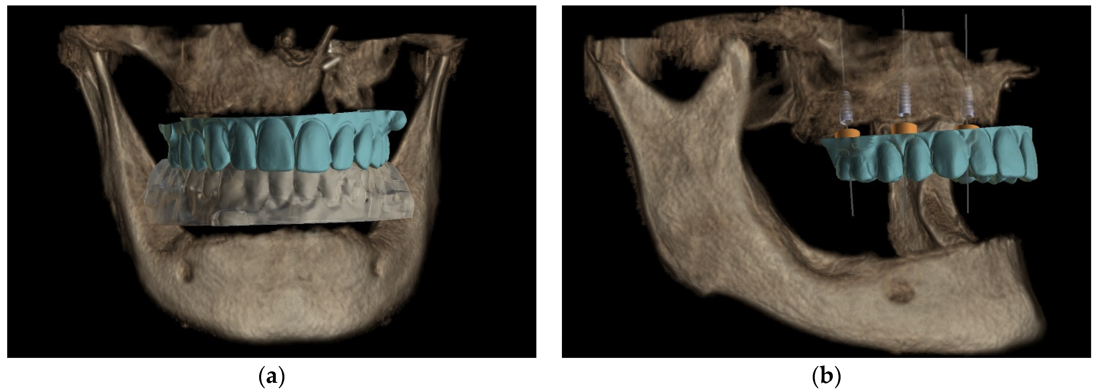 Prosthetically Driven Approach to Post-Ablative Maxilla Rehabilitation ...