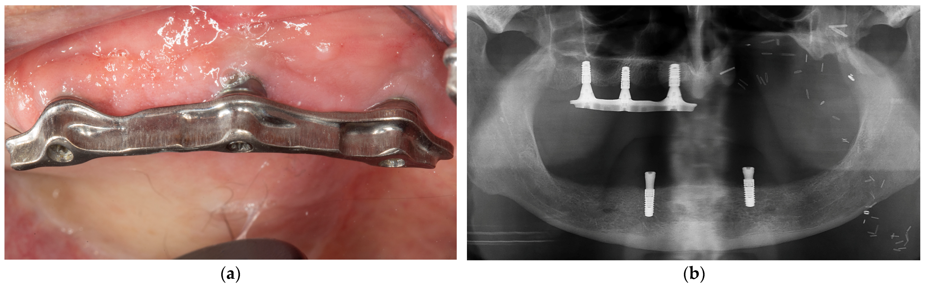 Prosthetically Driven Approach to Post-Ablative Maxilla Rehabilitation ...