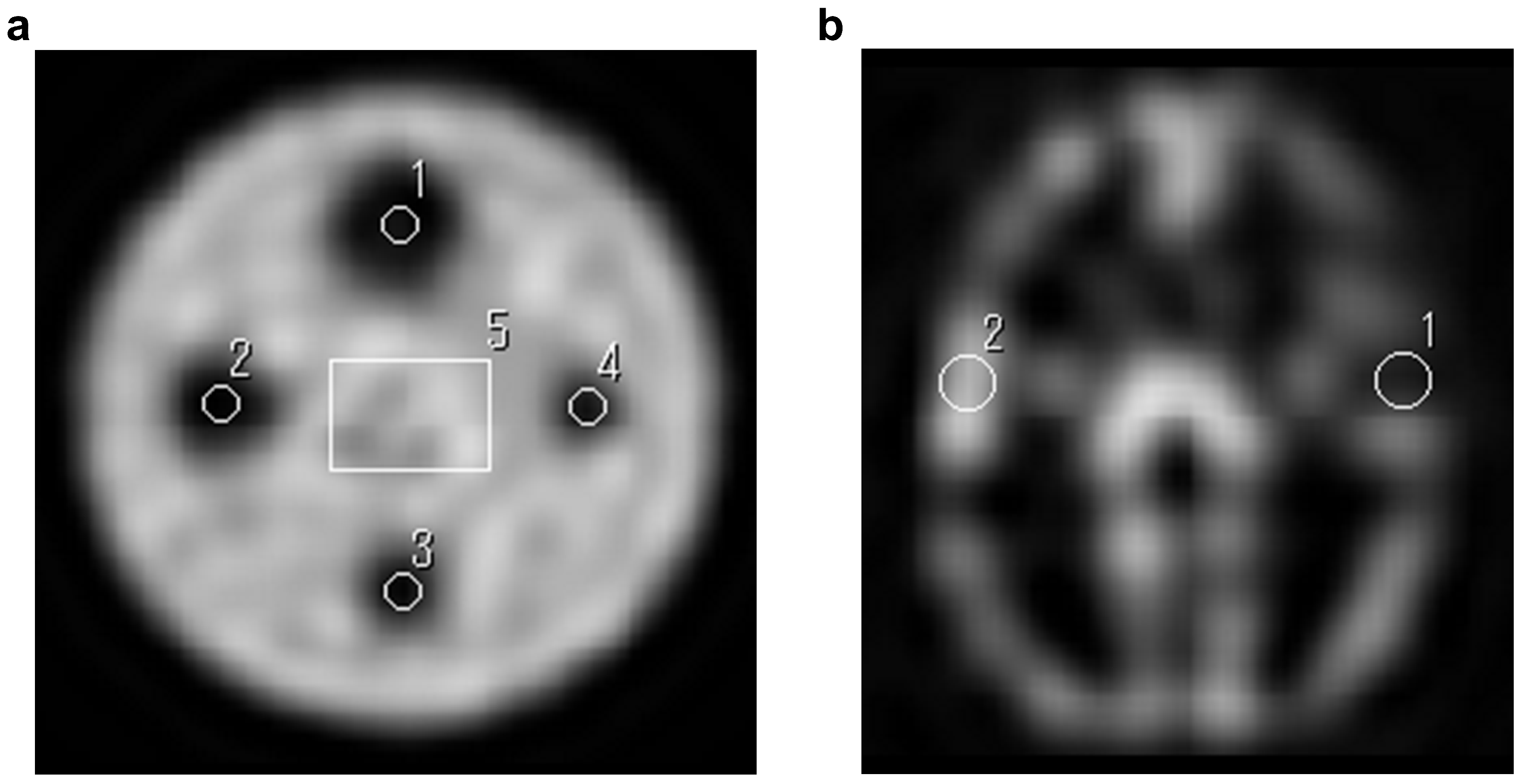 Evaluation of Scatter Correction Methods in SPECT Images: A Phantom ...