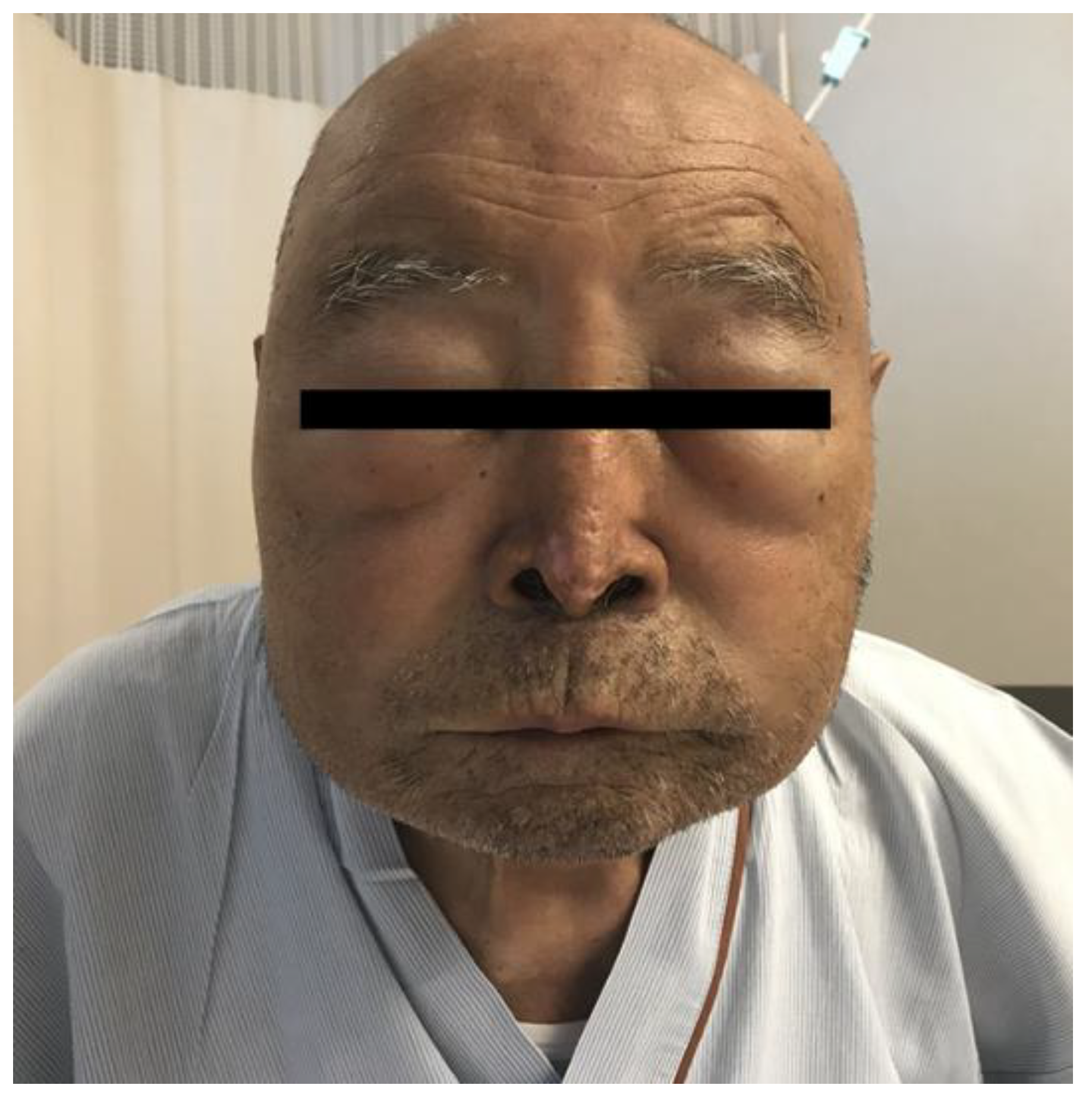 Reports Free Full Text Acute Facial Edema In A Patient With Reports Free Full Text Acute Facial Edema In A Patient With