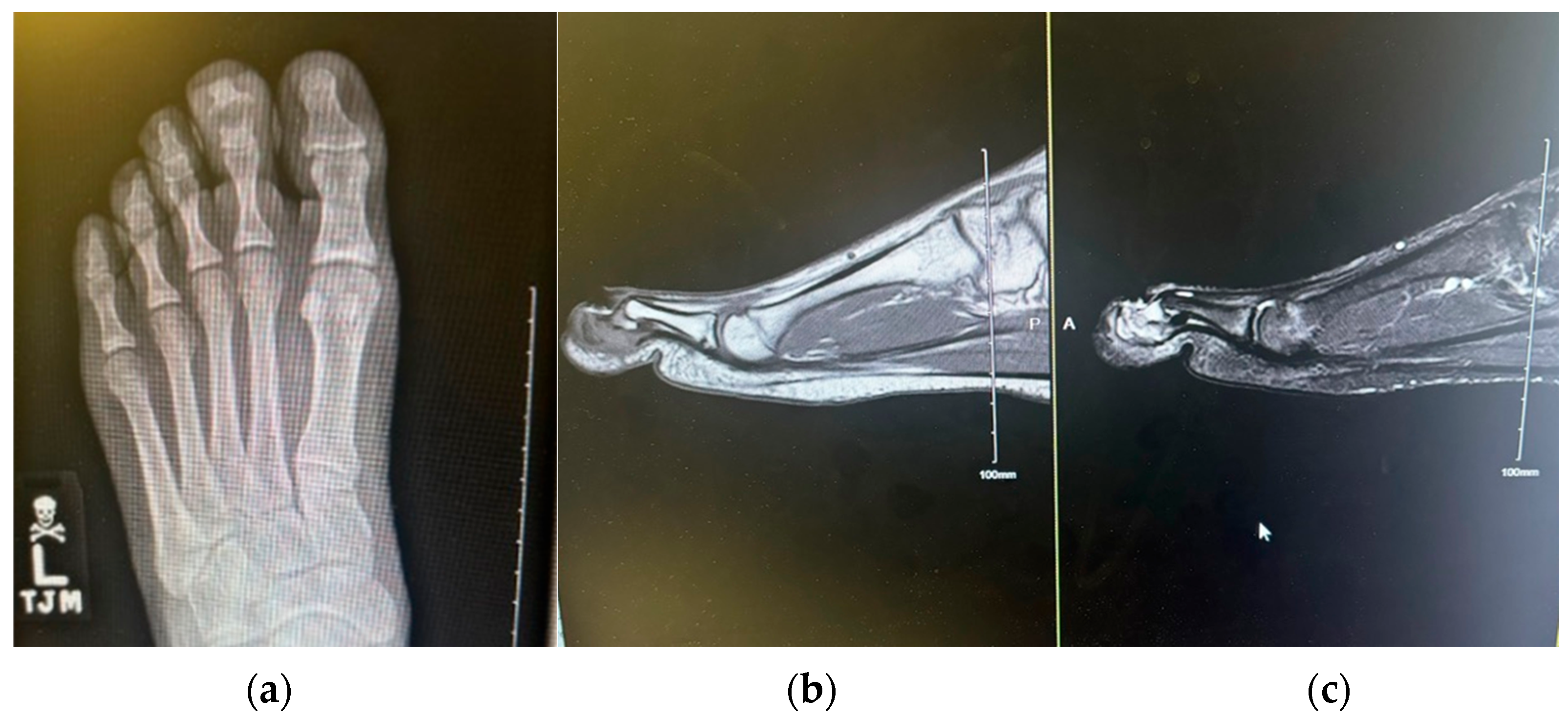 Limb-Sparing Reconstruction for Chronic Non-Bacterial Osteomyelitis of ...