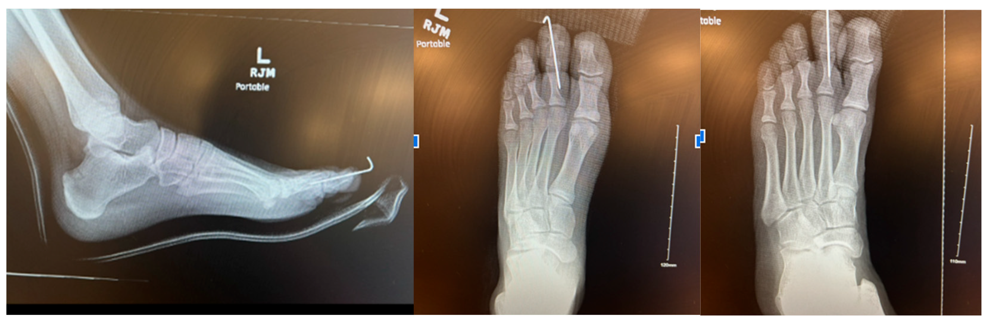 Limb-Sparing Reconstruction for Chronic Non-Bacterial Osteomyelitis of ...