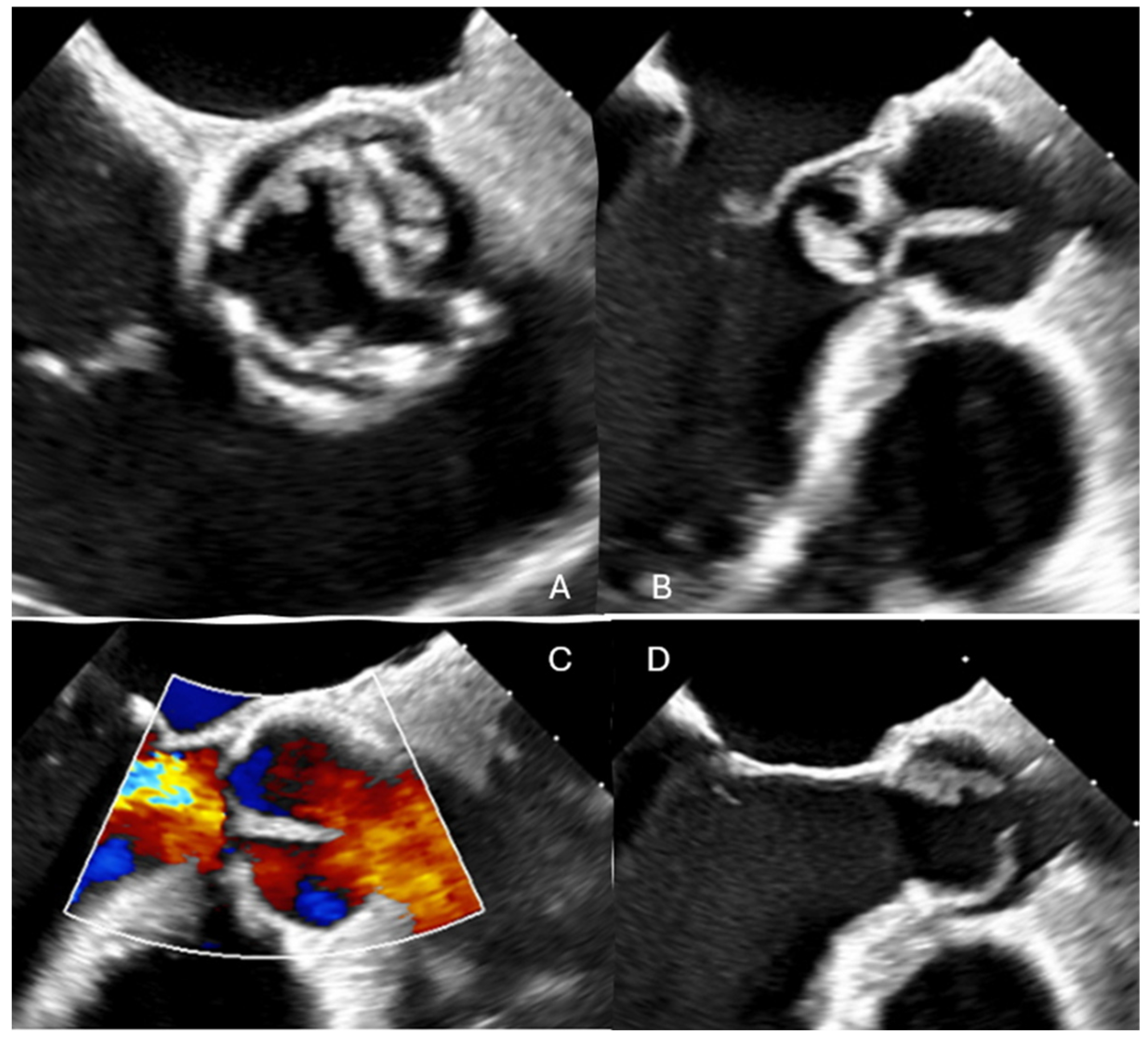 First-in-Man Use of Sutureless Perceval Valve for Endocarditis After ...