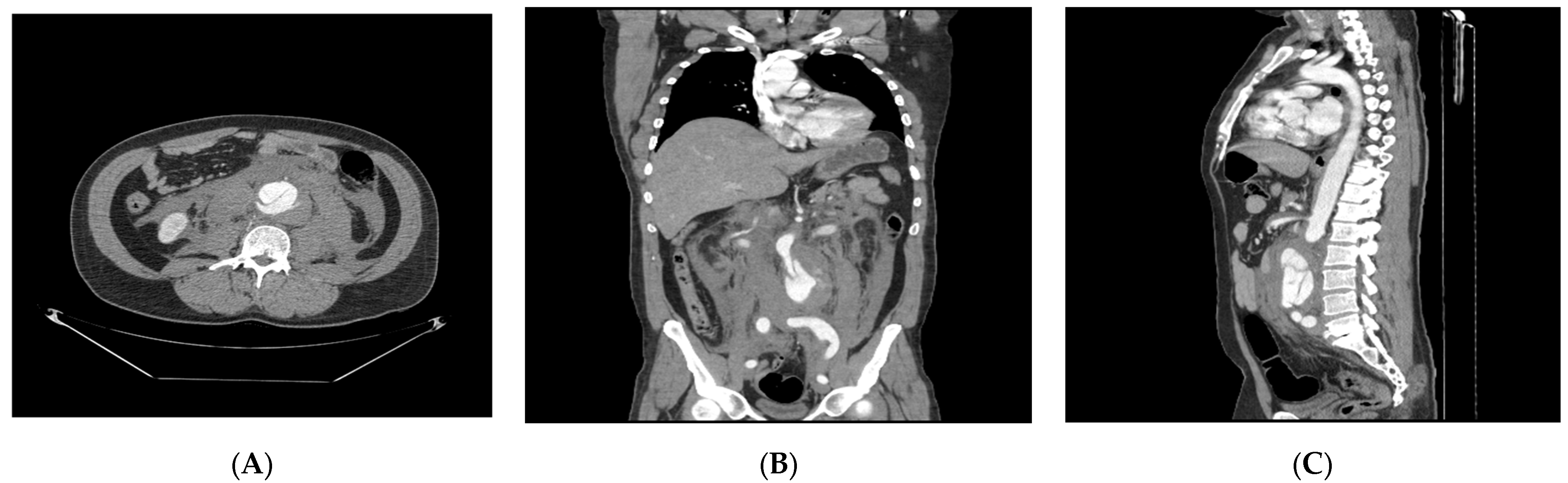 Imaging-Based Diagnosis of a Ruptured Isolated Dissecting Abdominal ...