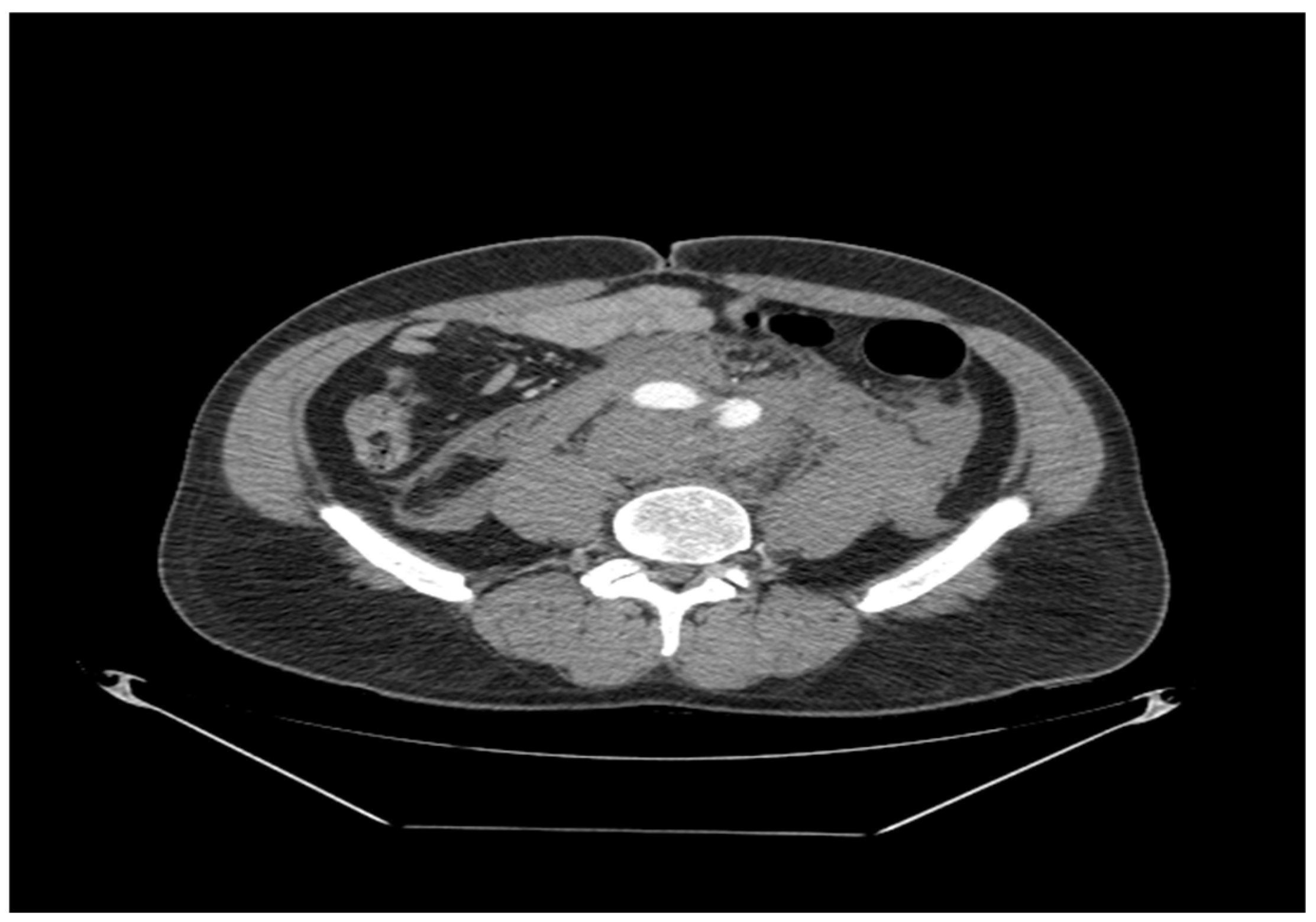 Imaging-Based Diagnosis of a Ruptured Isolated Dissecting Abdominal ...