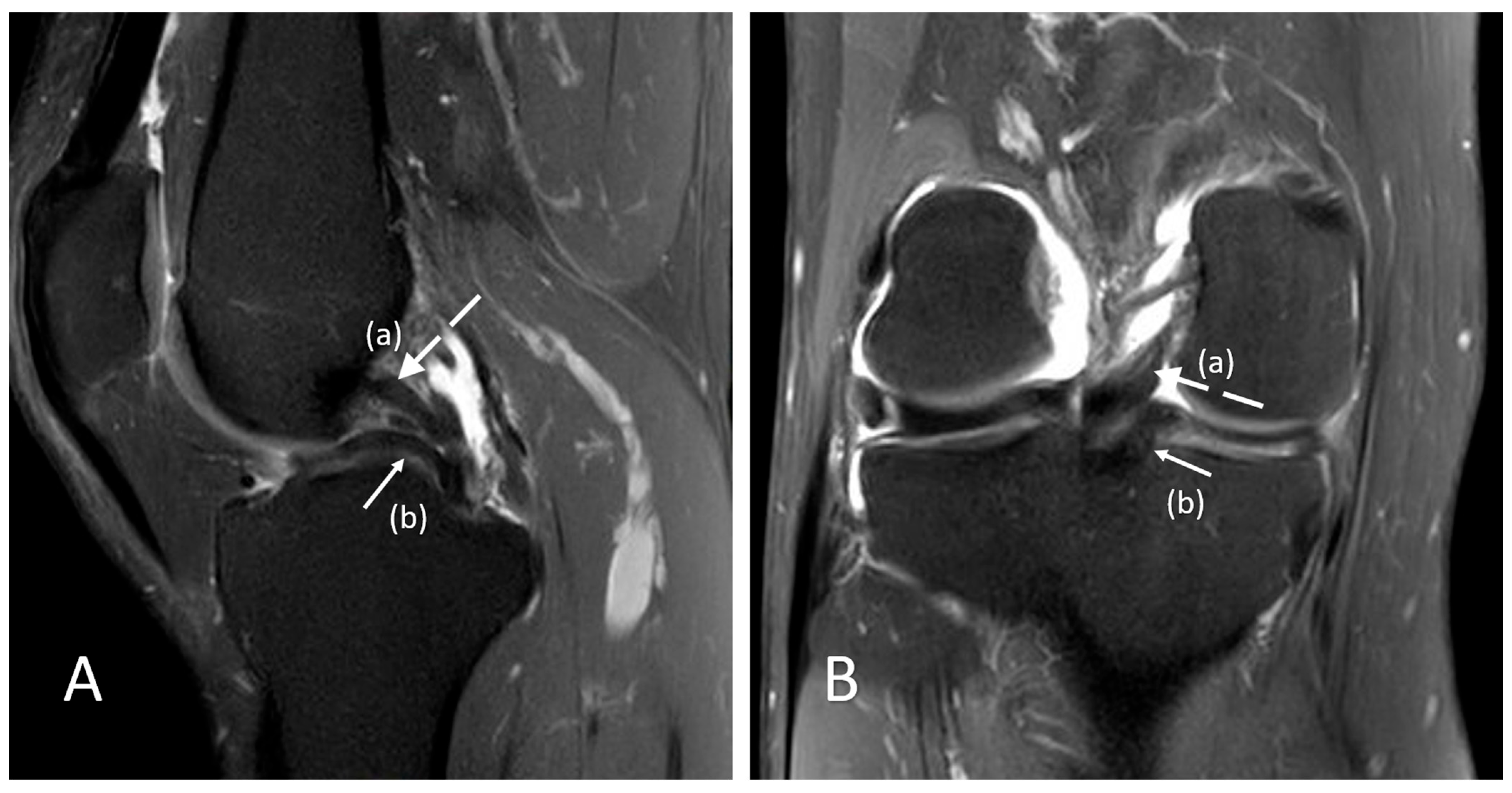 Double Posterior Cruciate Ligament Sign