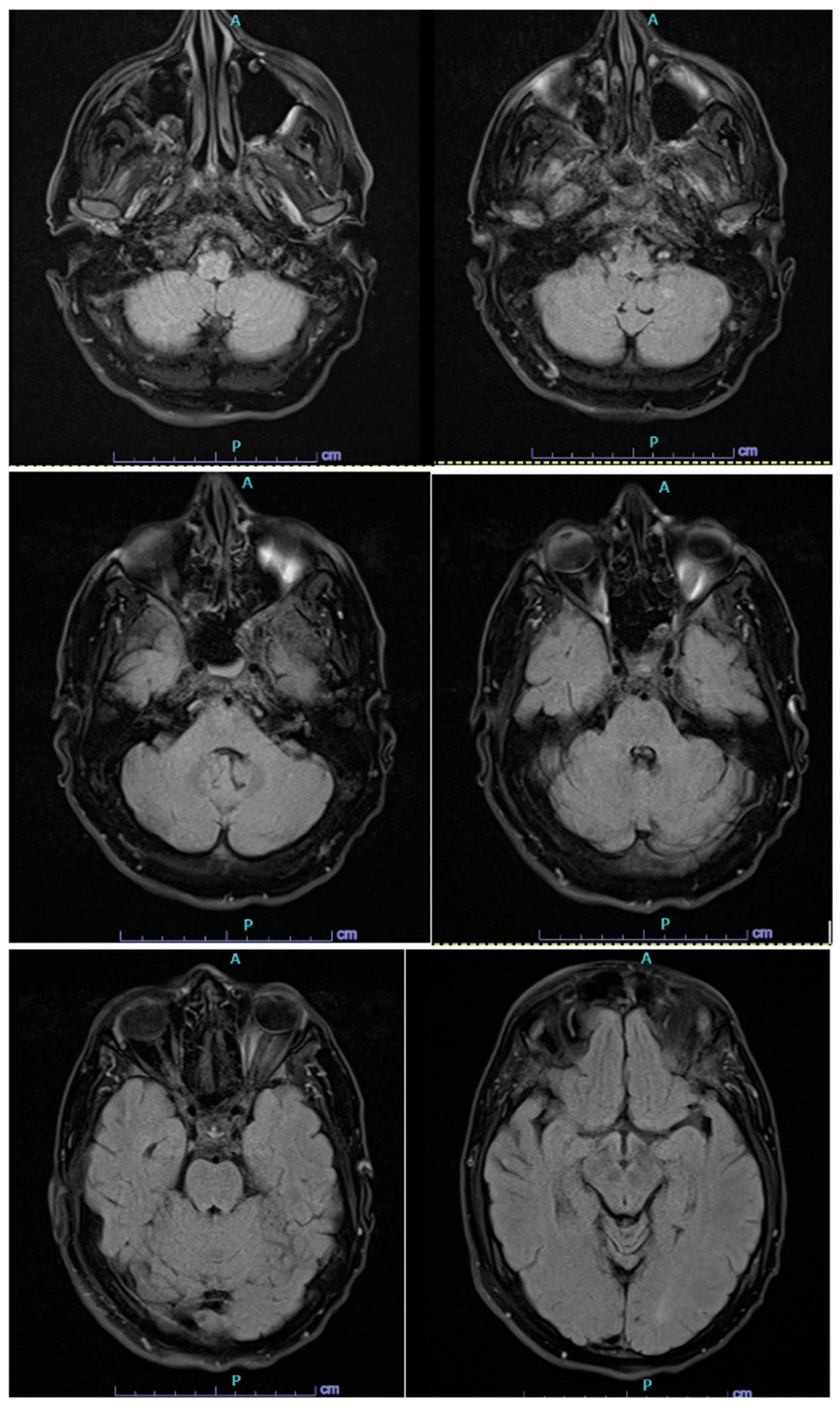 Lessons from a Severe Case of Fulminant Guillain–Barré Syndrome: A Case ...