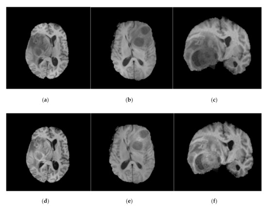 Brain MR Image Enhancement for Tumor Segmentation Using 3D U-Net