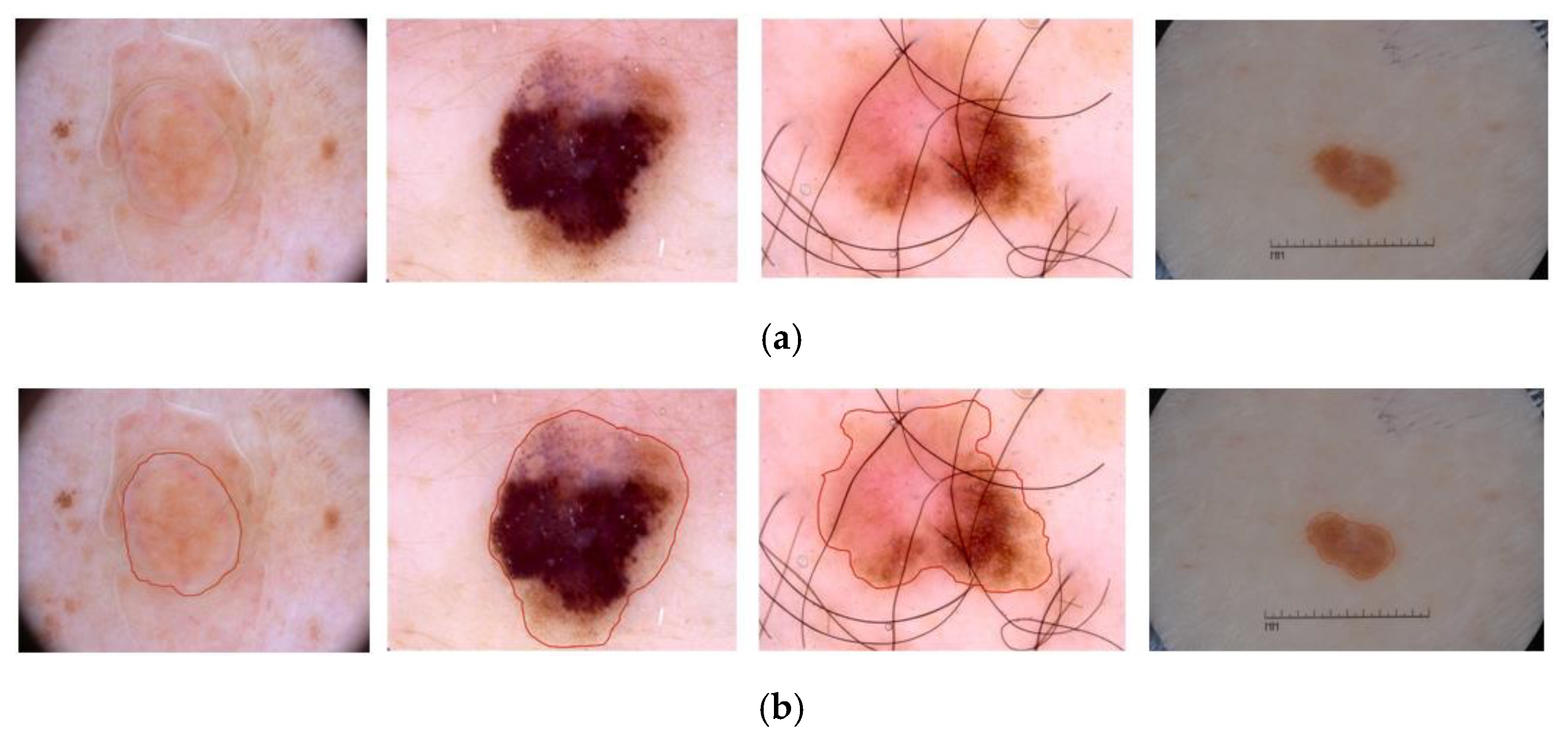 MHAU-Net: Skin Lesion Segmentation Based on Multi-Scale Hybrid Residual Attention Network