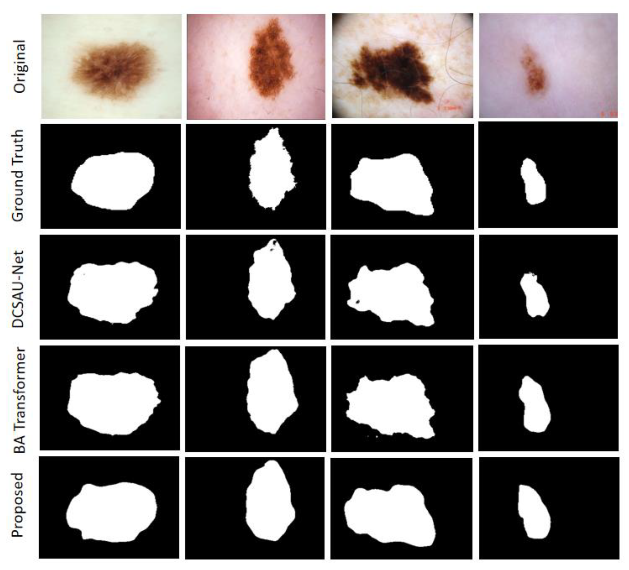 MHAU-Net: Skin Lesion Segmentation Based on Multi-Scale Hybrid Residual Attention Network