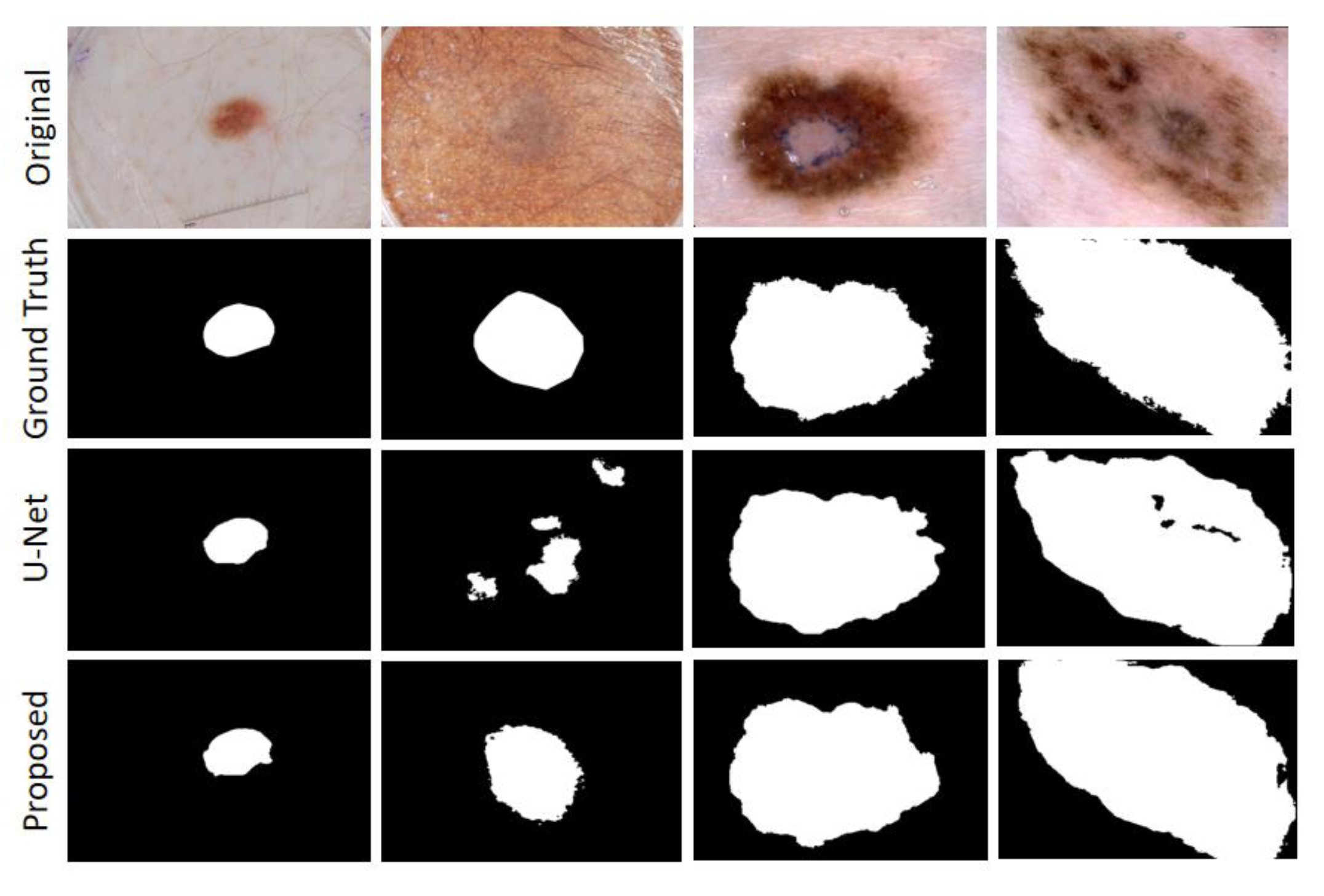MHAU-Net: Skin Lesion Segmentation Based on Multi-Scale Hybrid Residual Attention Network