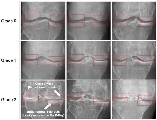 Classification of Grades of Subchondral Sclerosis from Knee ...