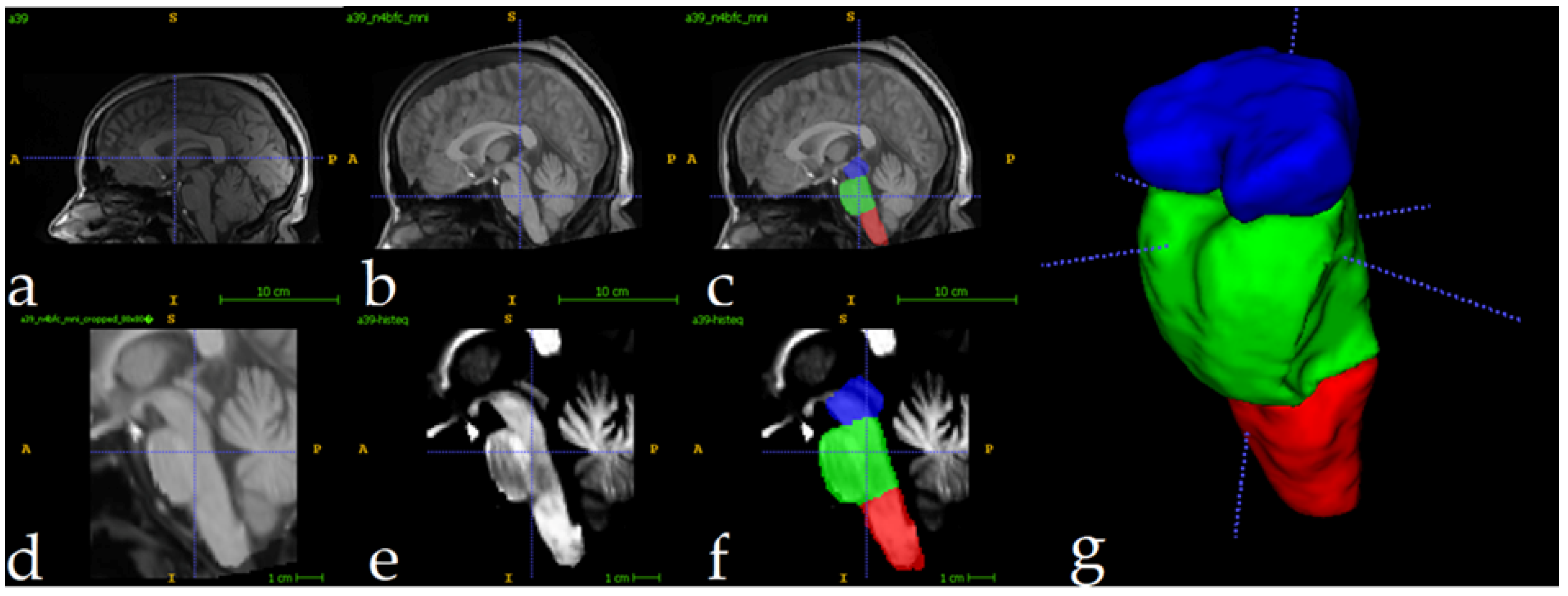 Deep Learning-Based Assessment of Brainstem Volume Changes in Spinocerebellar Ataxia Type 2 ...