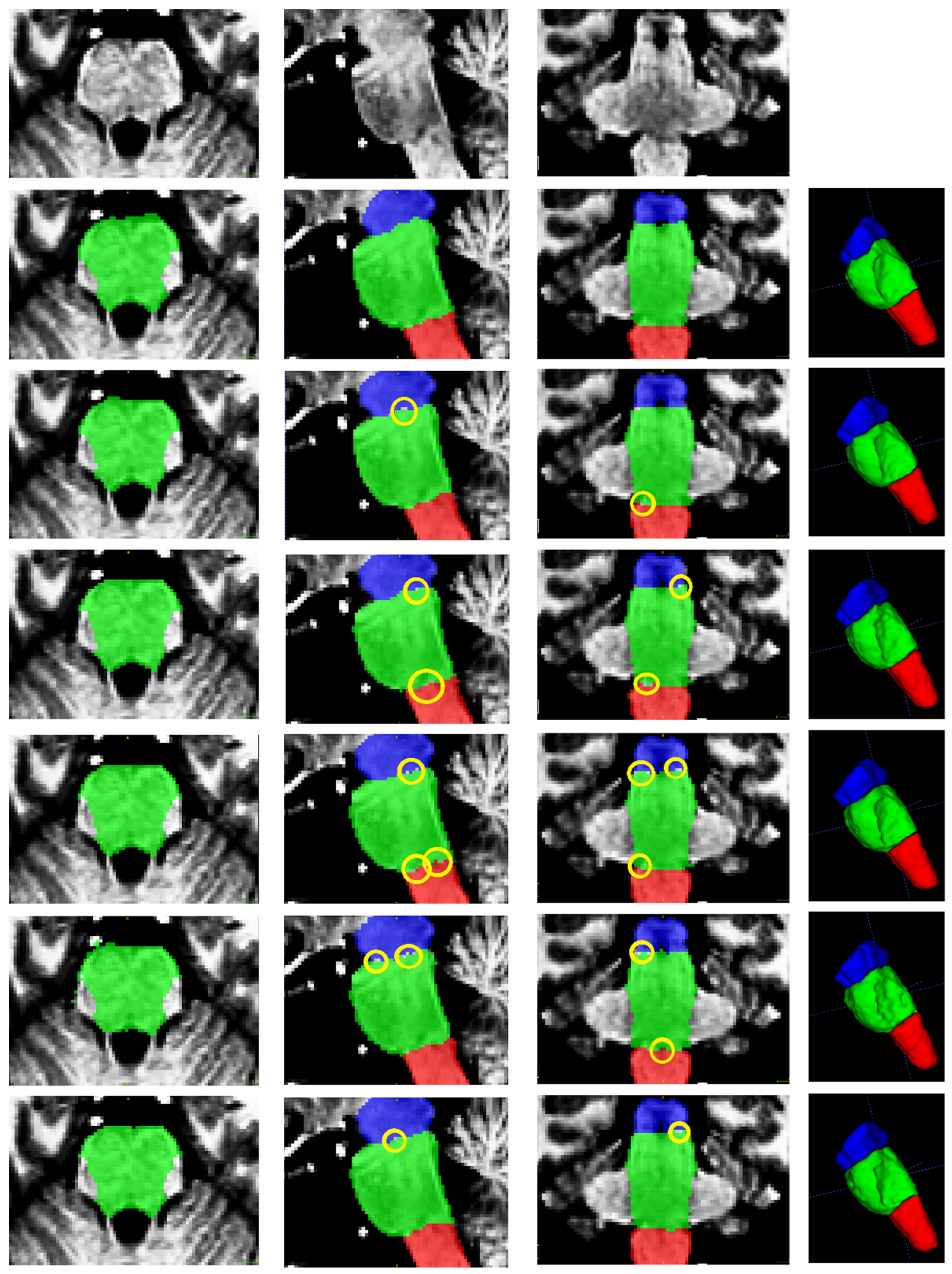 Deep Learning-Based Assessment of Brainstem Volume Changes in Spinocerebellar Ataxia Type 2 ...