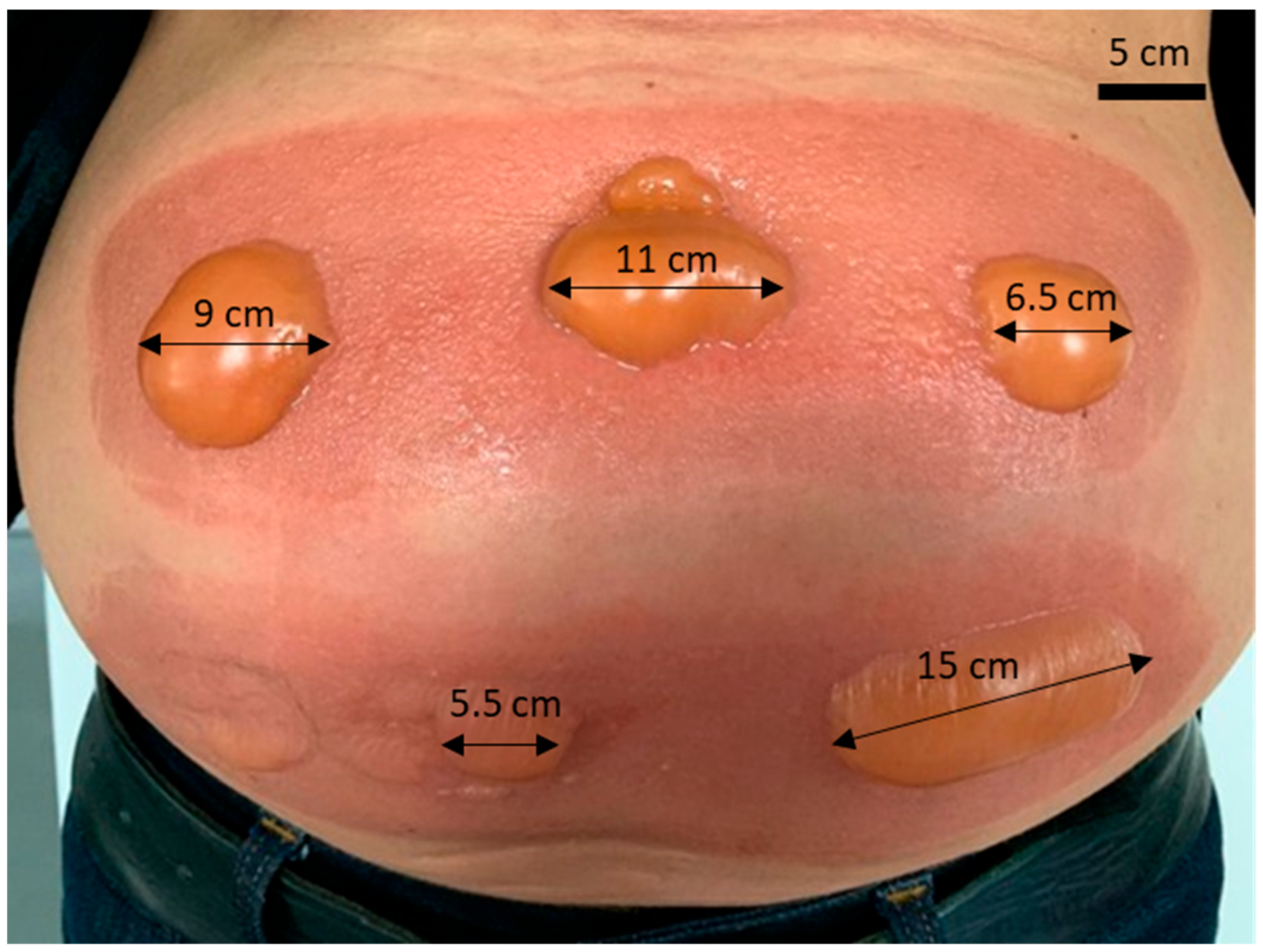 Fractional-Order Bioimpedance Modelling for Early Detection of Tissue ...