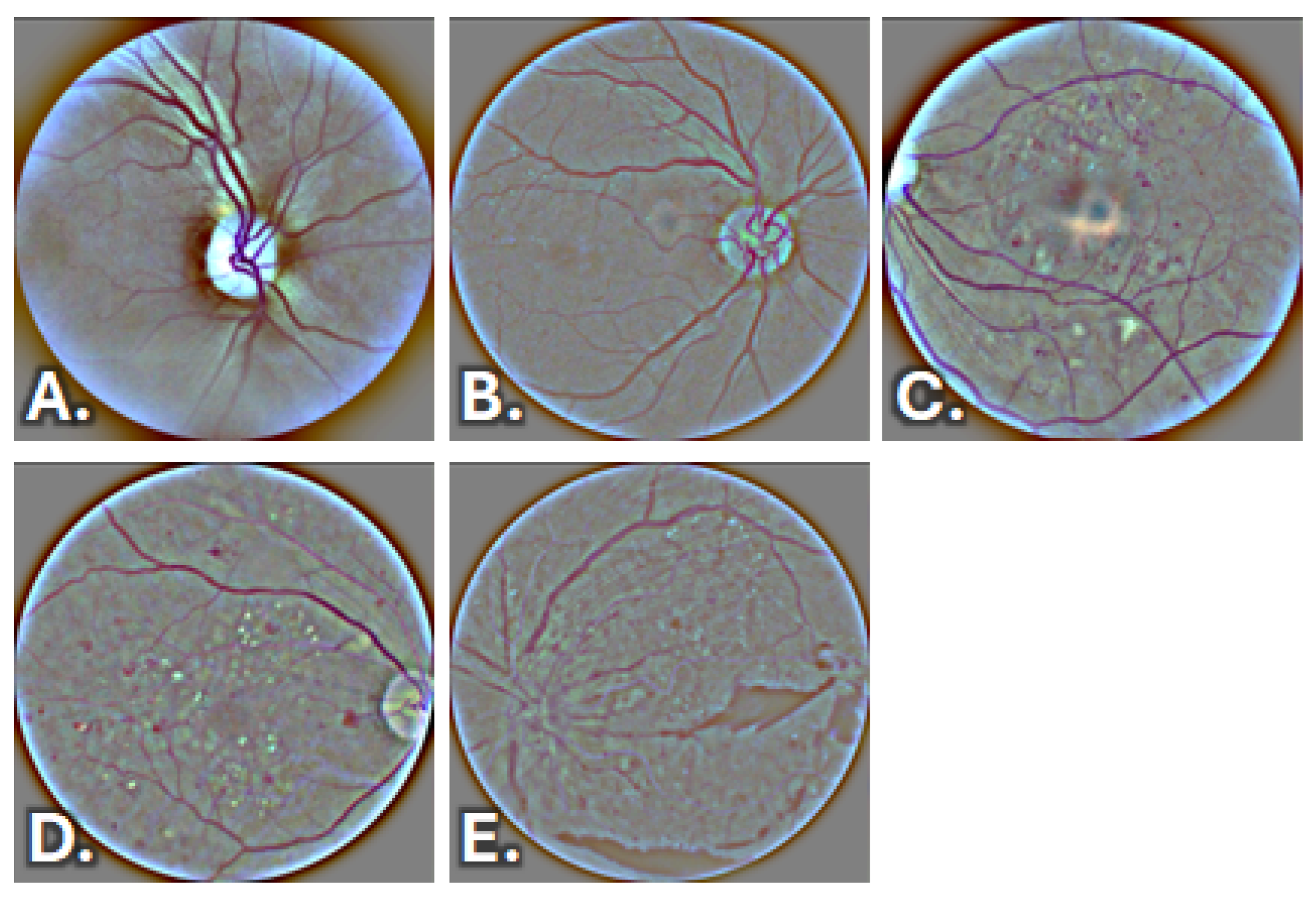 A Novel Convolutional Neural Network for Explainable Diabetic ...