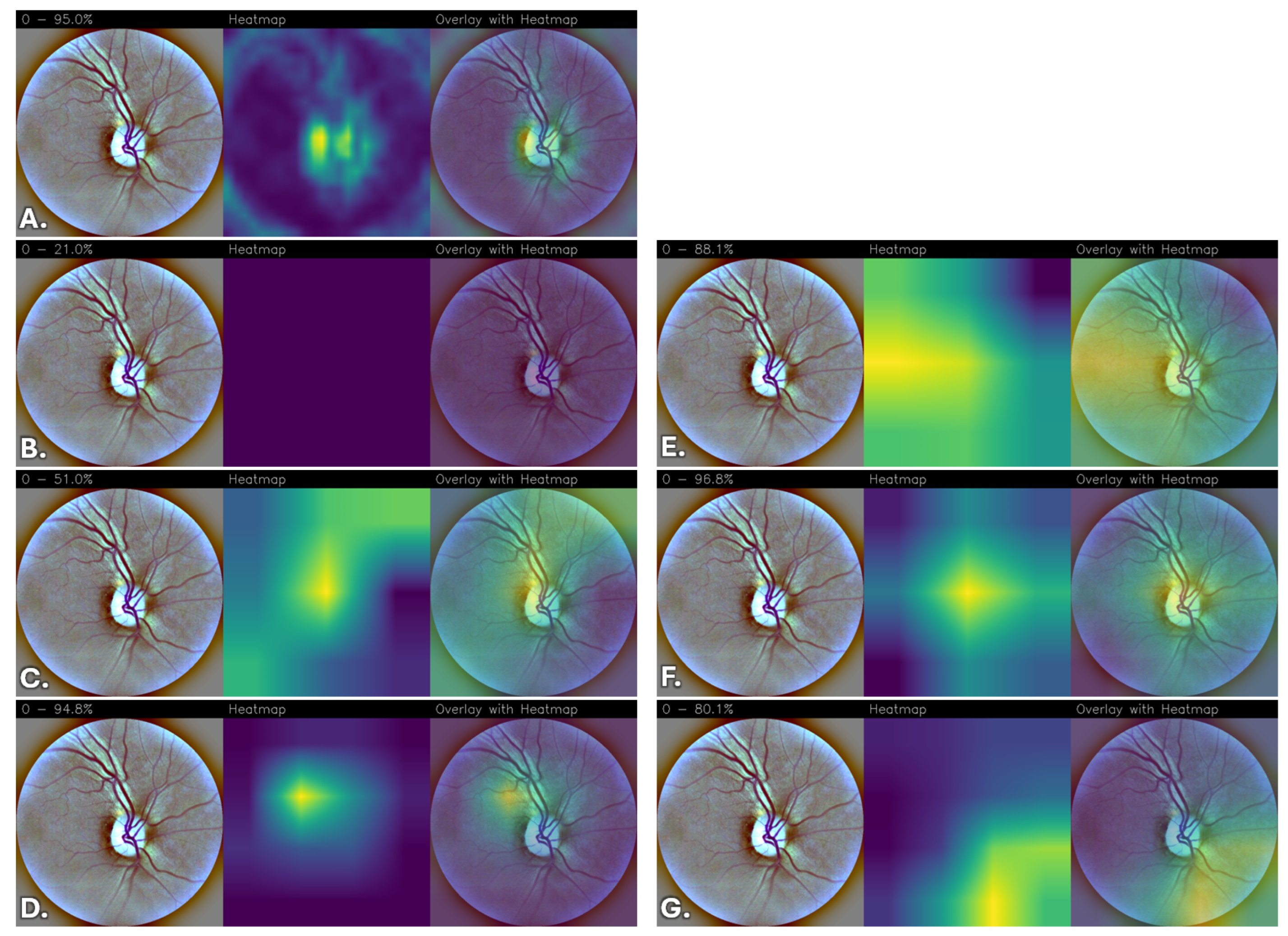A Novel Convolutional Neural Network for Explainable Diabetic ...