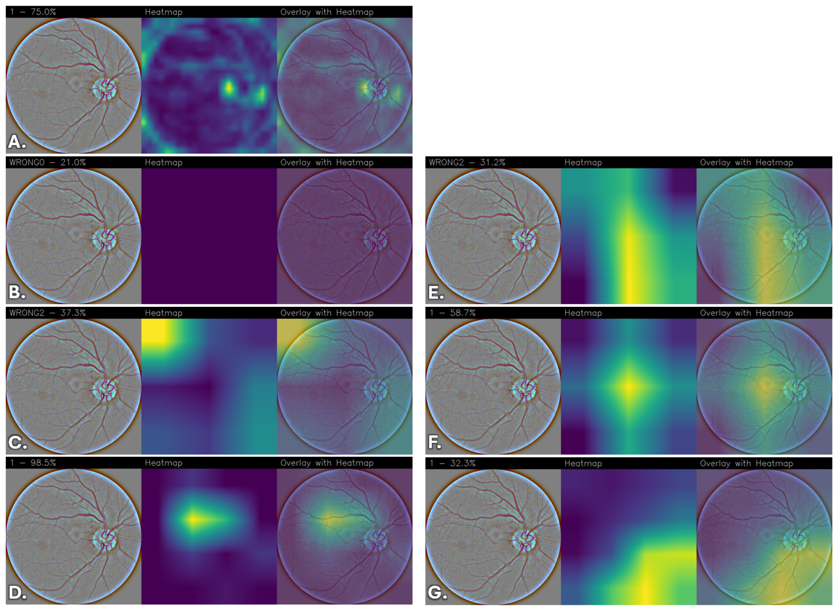 A Novel Convolutional Neural Network for Explainable Diabetic ...