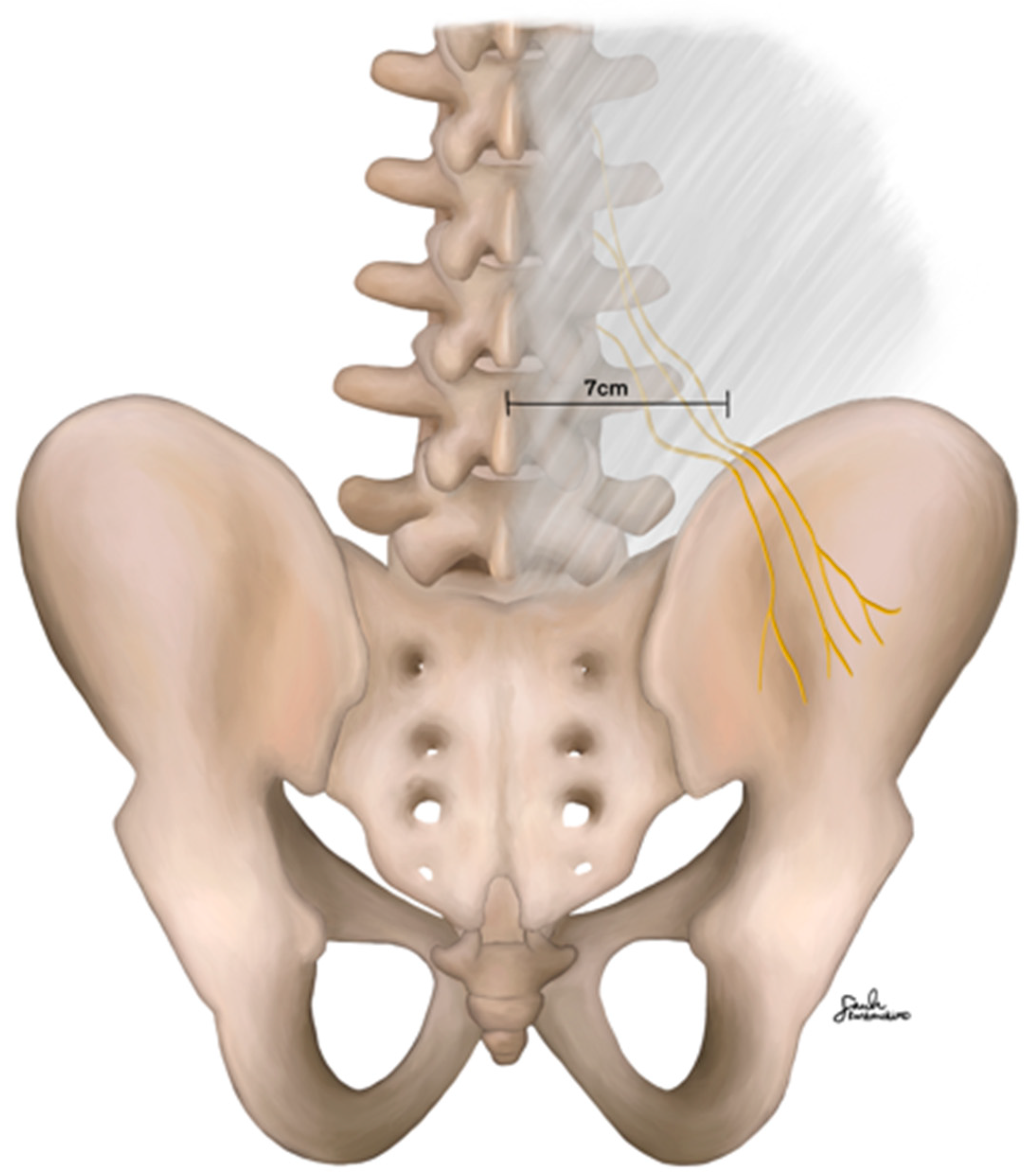 Surgical Technique for Superior Cluneal Nerve Decompression
