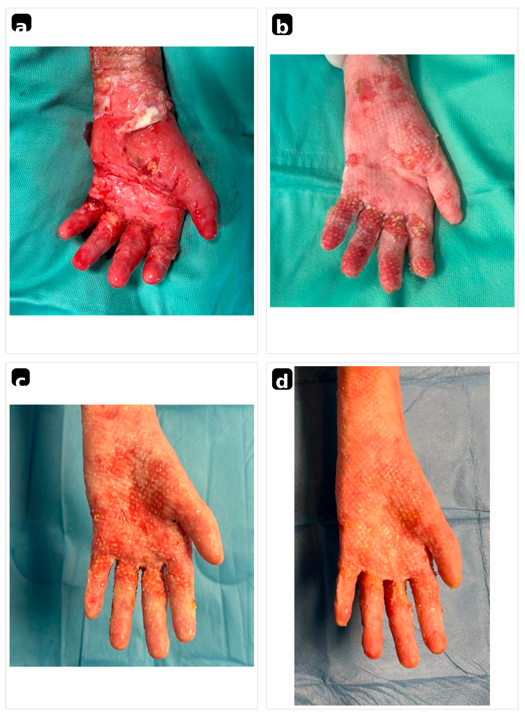 Intact Fish Skin Graft in the Treatment of EB Hand: A New Weapon in ...