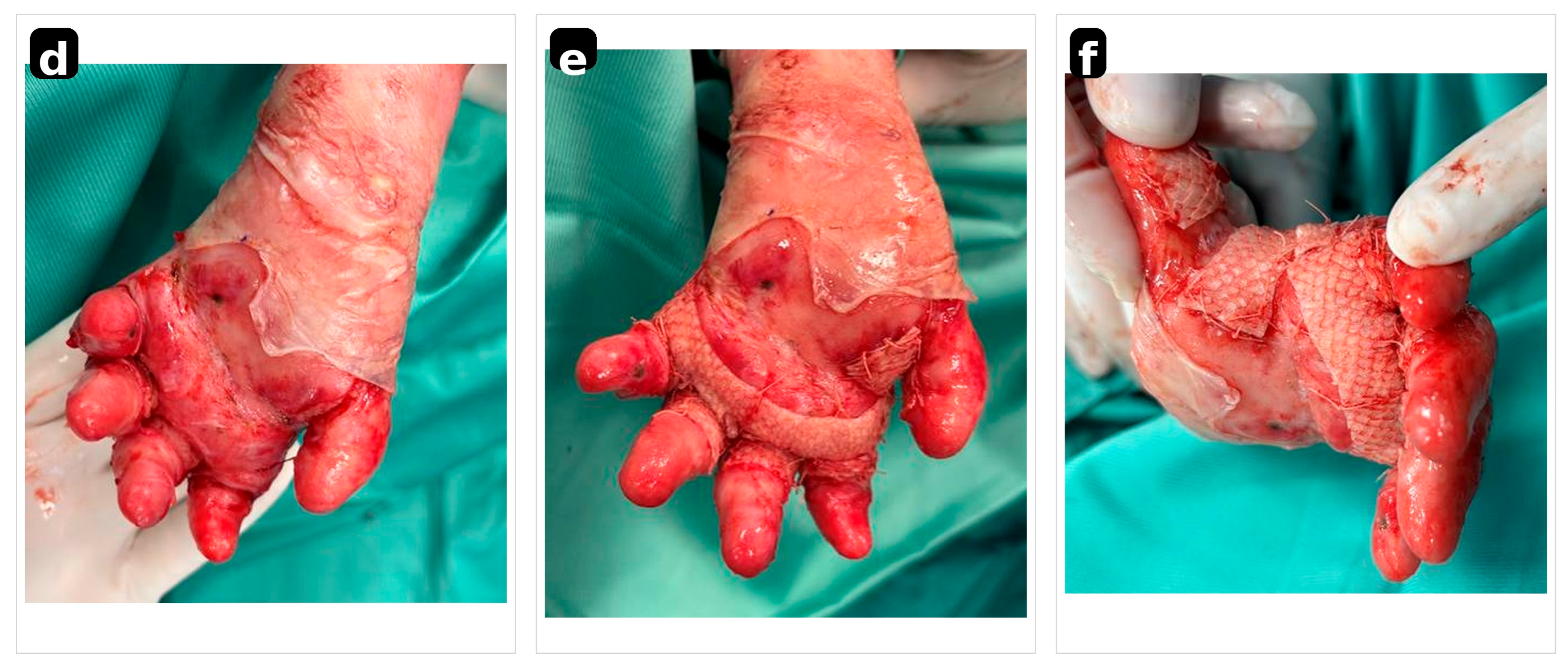 Intact Fish Skin Graft in the Treatment of EB Hand: A New Weapon in ...
