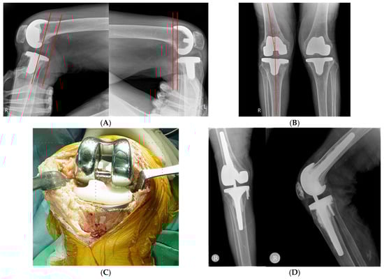 Treatments of Polyethylene Tibial Post Fracture in Posterior Stabilized ...