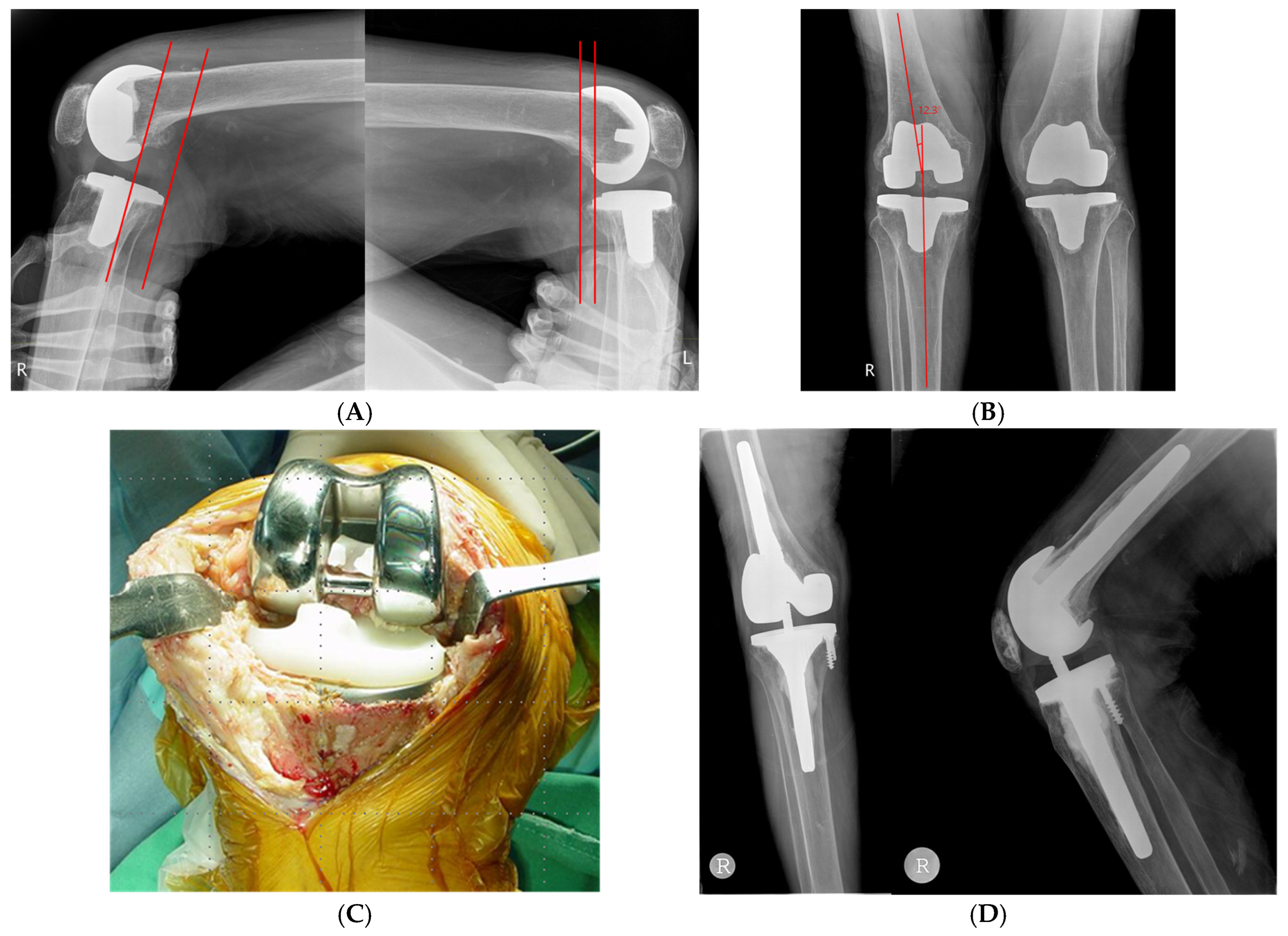 Treatments of Polyethylene Tibial Post Fracture in Posterior Stabilized ...