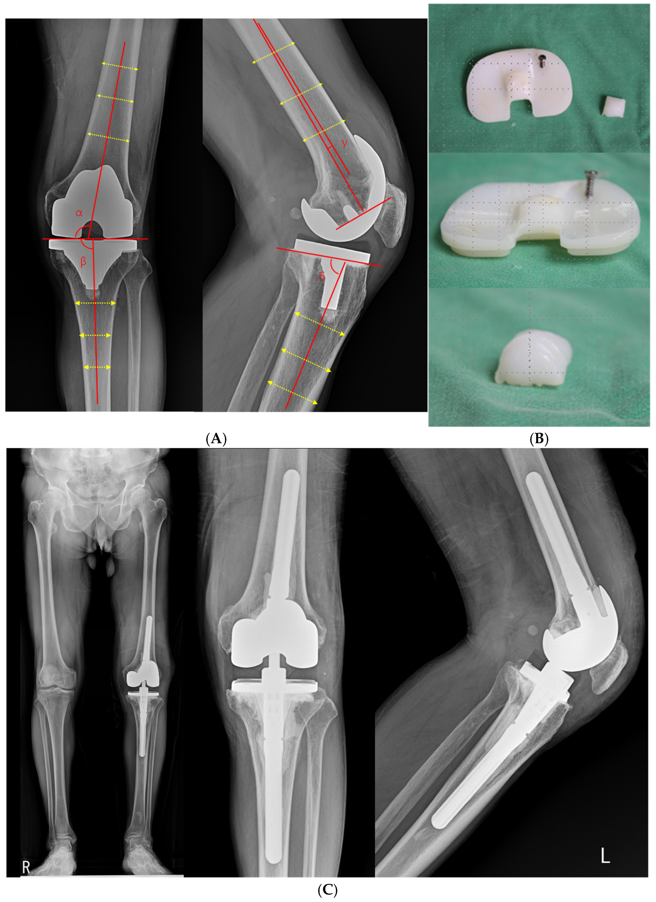 Treatments of Polyethylene Tibial Post Fracture in Posterior Stabilized ...