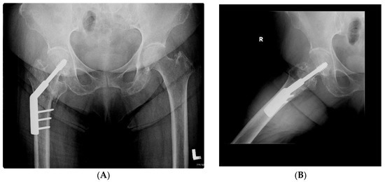 Functional Symmetry after Surgical Treatment of Pertrochanteric ...