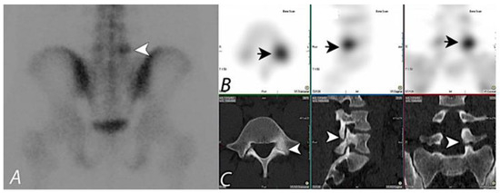 SPECT/CT in the Evaluation of Suspected Skeletal Pathology