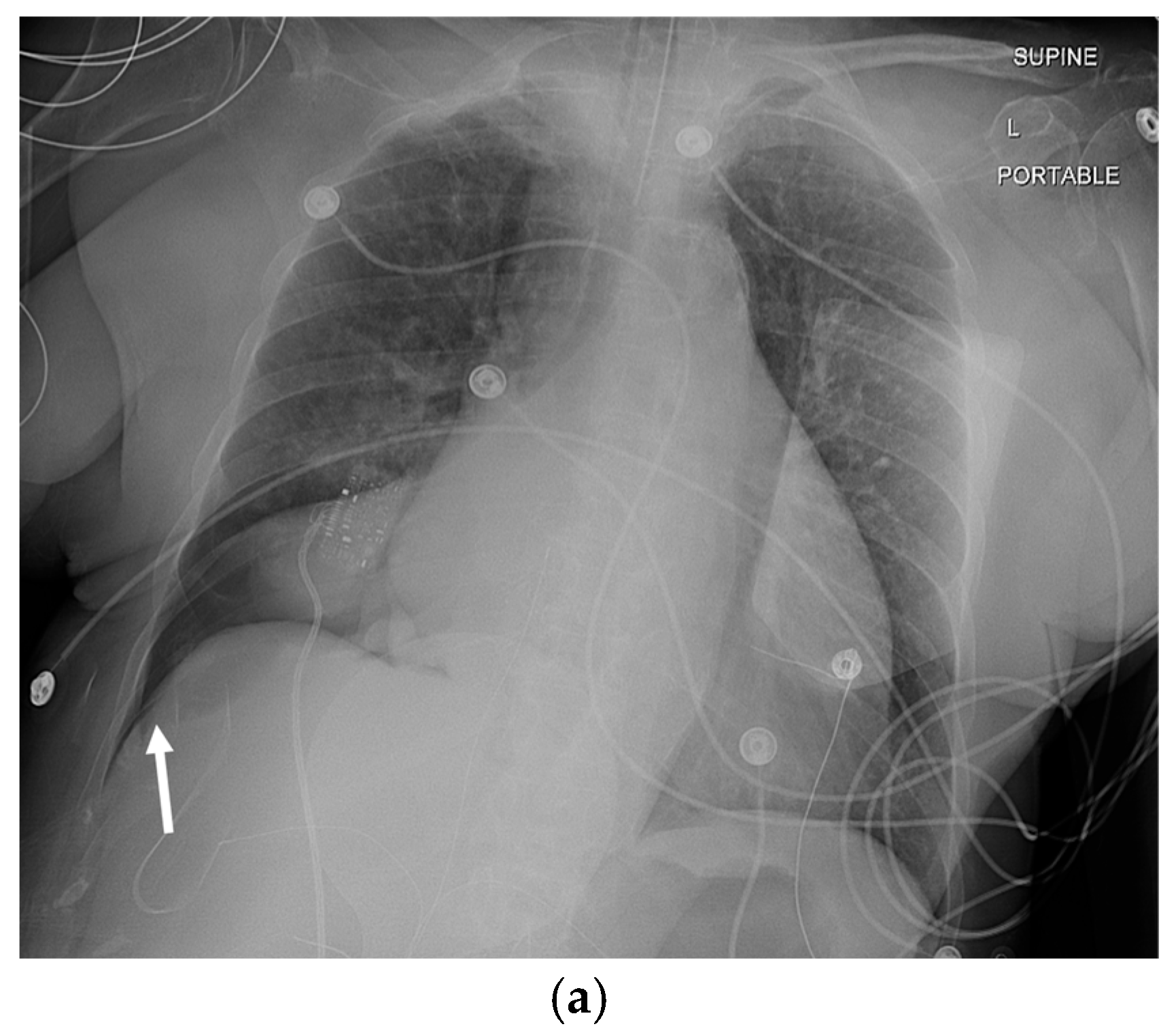 Spontaneous Pneumothorax: A Review of Underlying Etiologies and ...