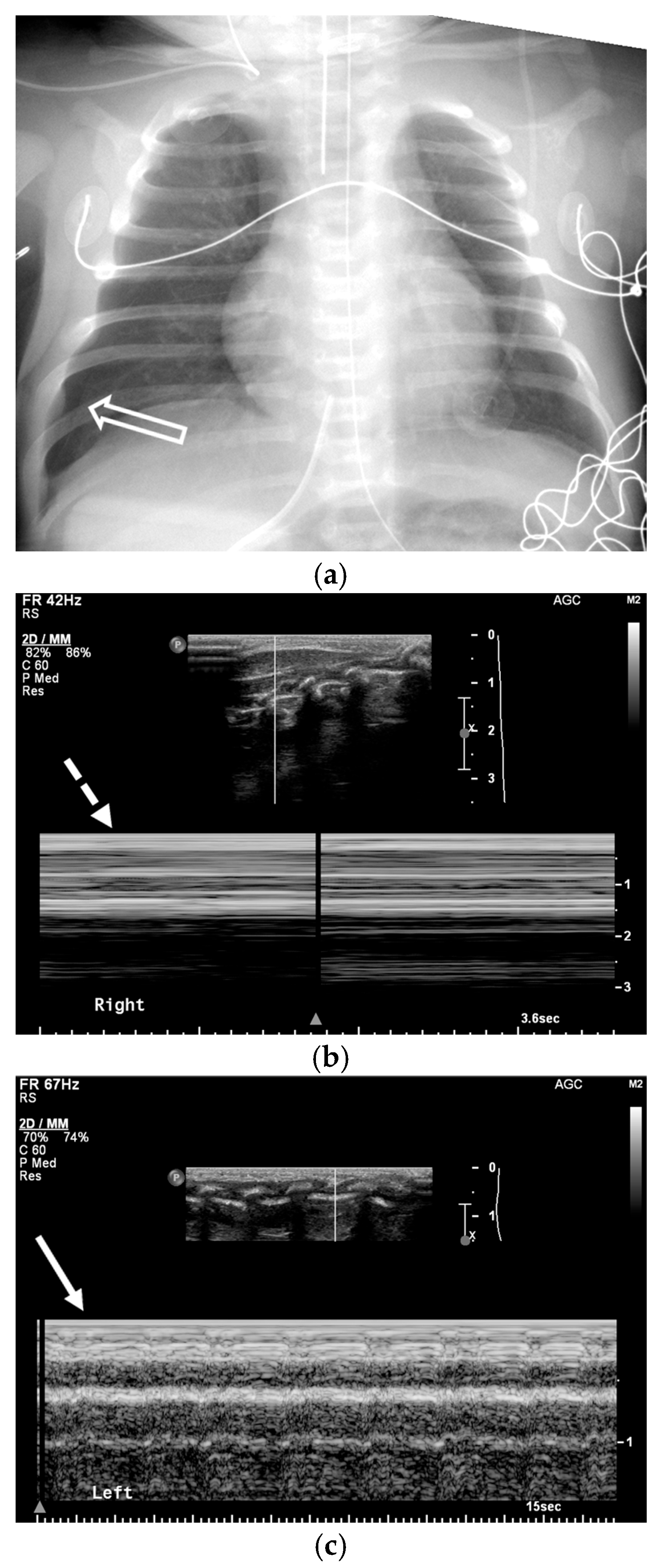 Spontaneous Pneumothorax: A Review of Underlying Etiologies and ...