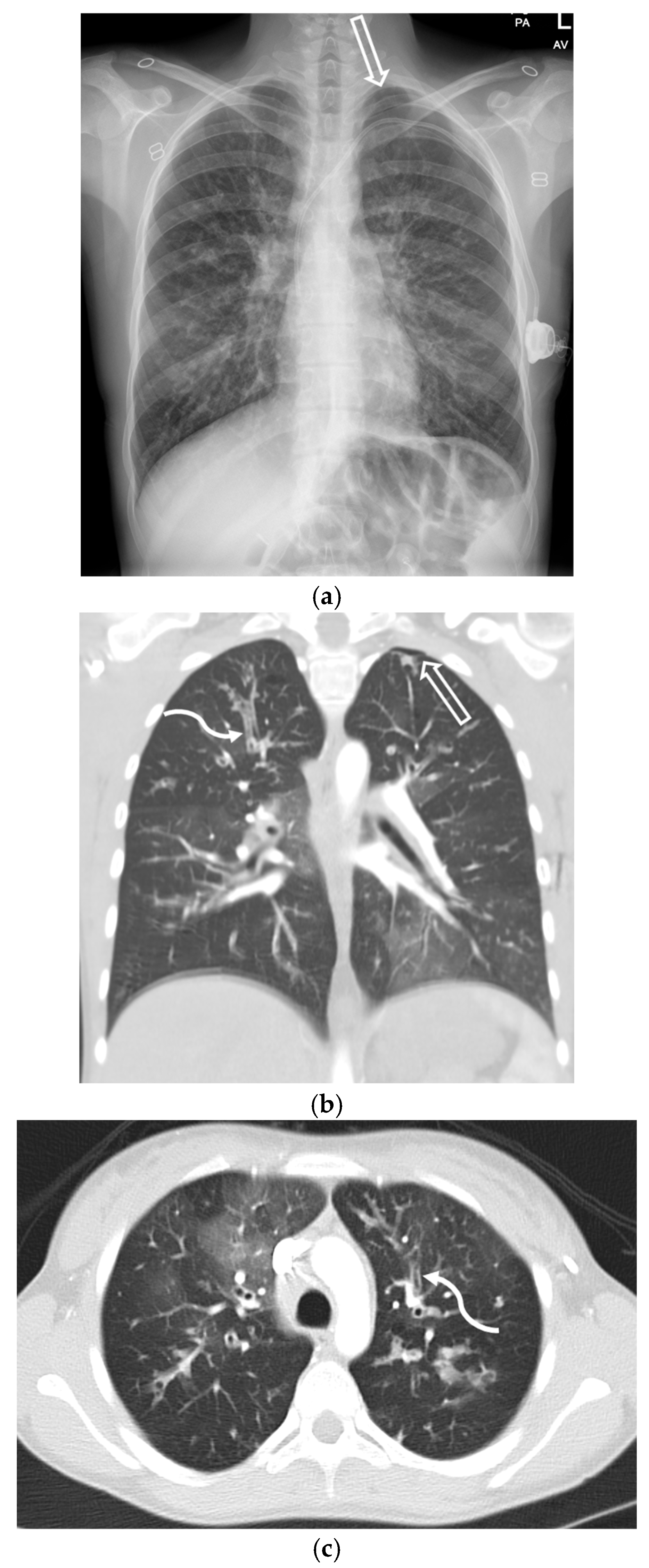 Spontaneous Pneumothorax: A Review of Underlying Etiologies and ...