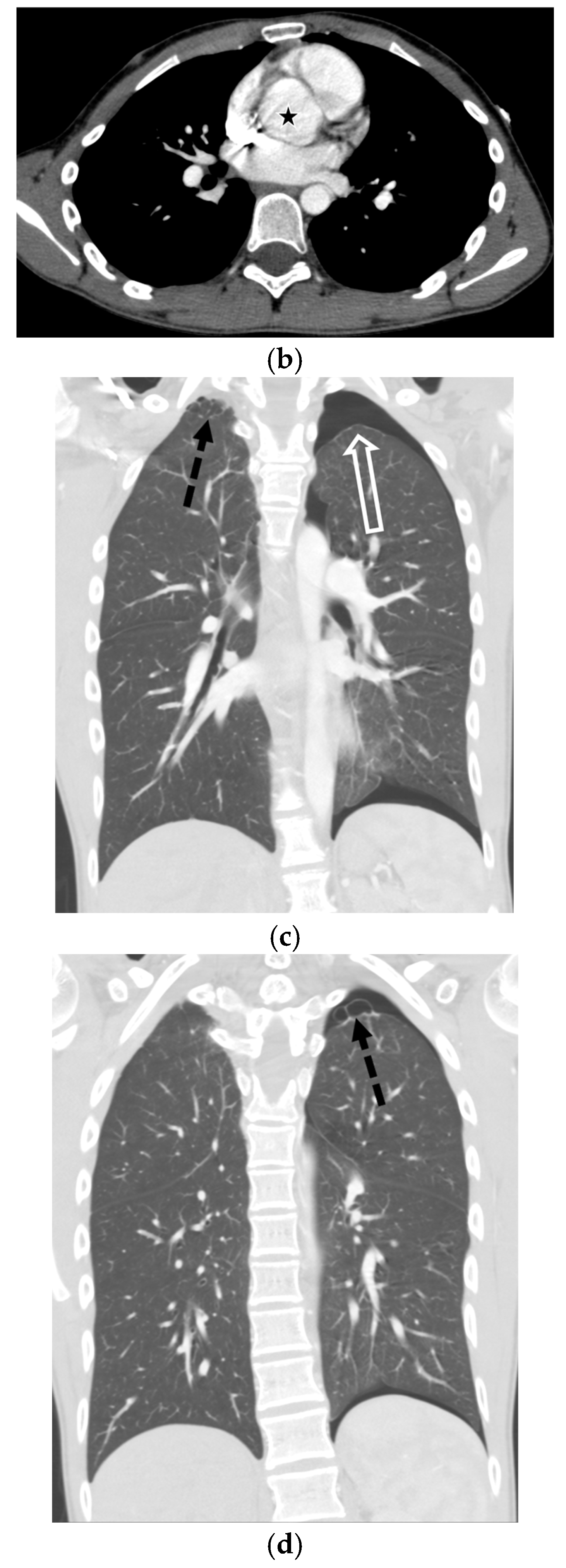 Spontaneous Pneumothorax: A Review of Underlying Etiologies and ...