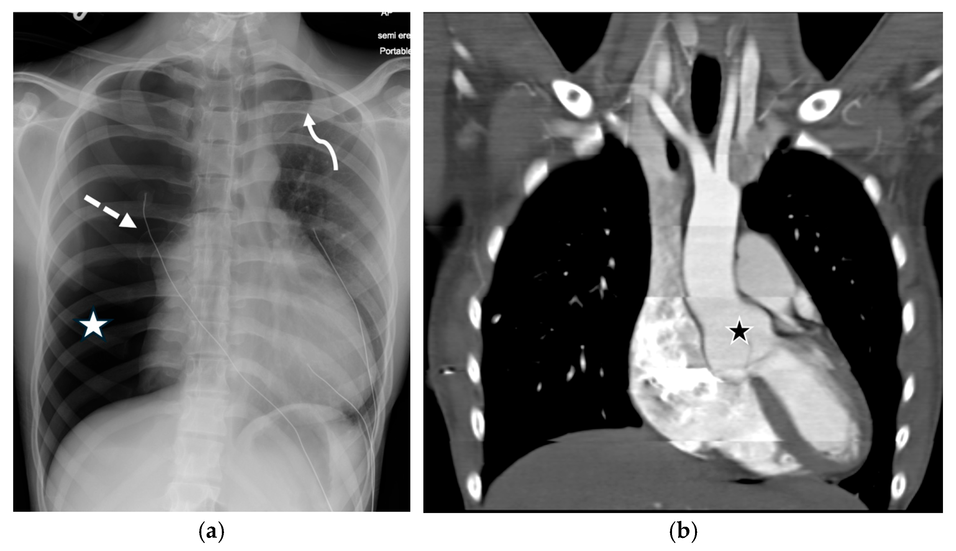 Spontaneous Pneumothorax: A Review of Underlying Etiologies and ...