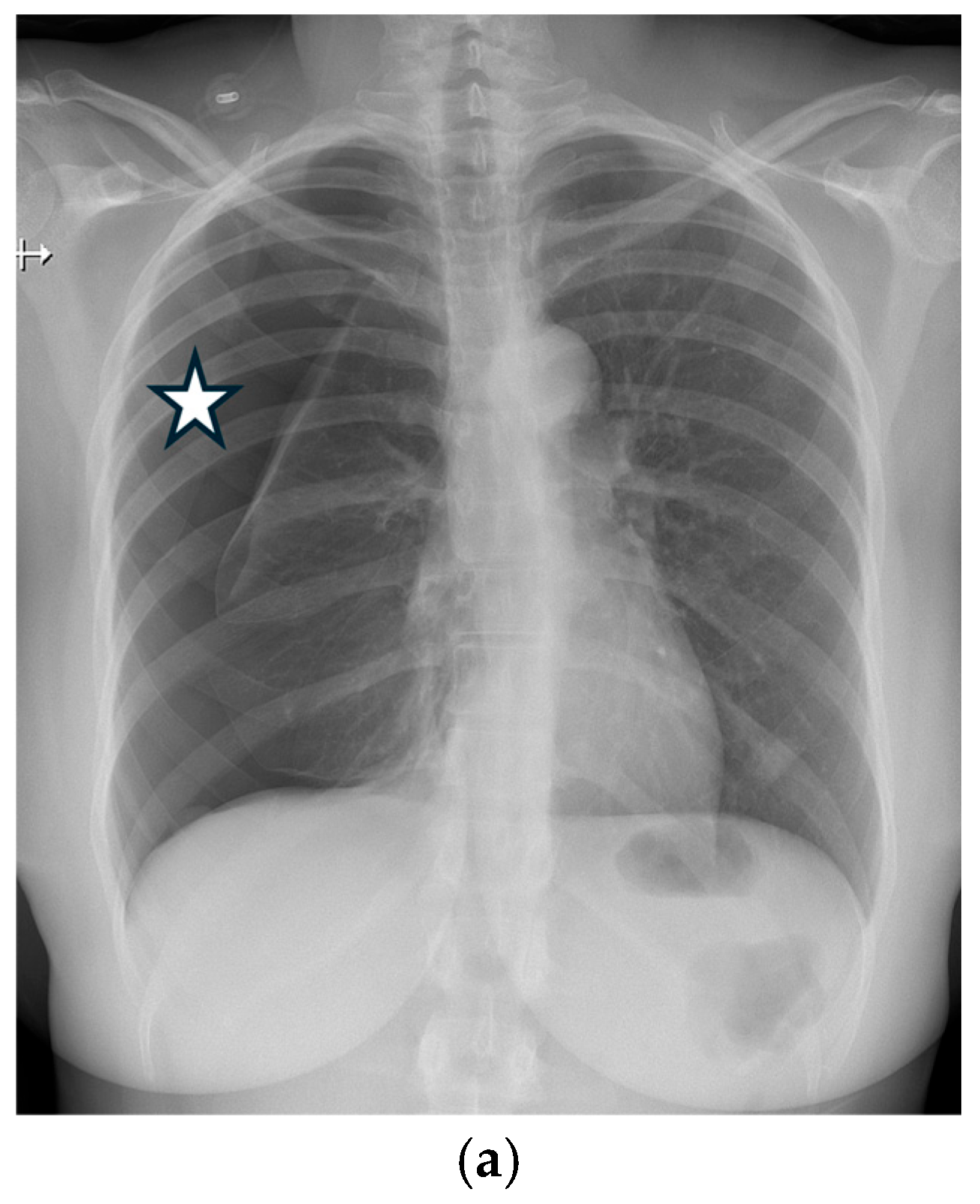 Spontaneous Pneumothorax: A Review of Underlying Etiologies and ...