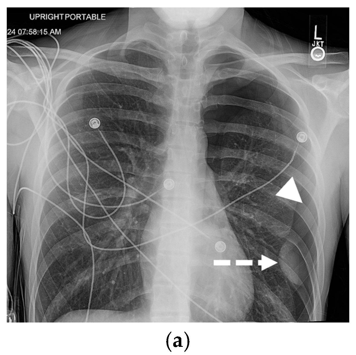 Spontaneous Pneumothorax: A Review of Underlying Etiologies and ...