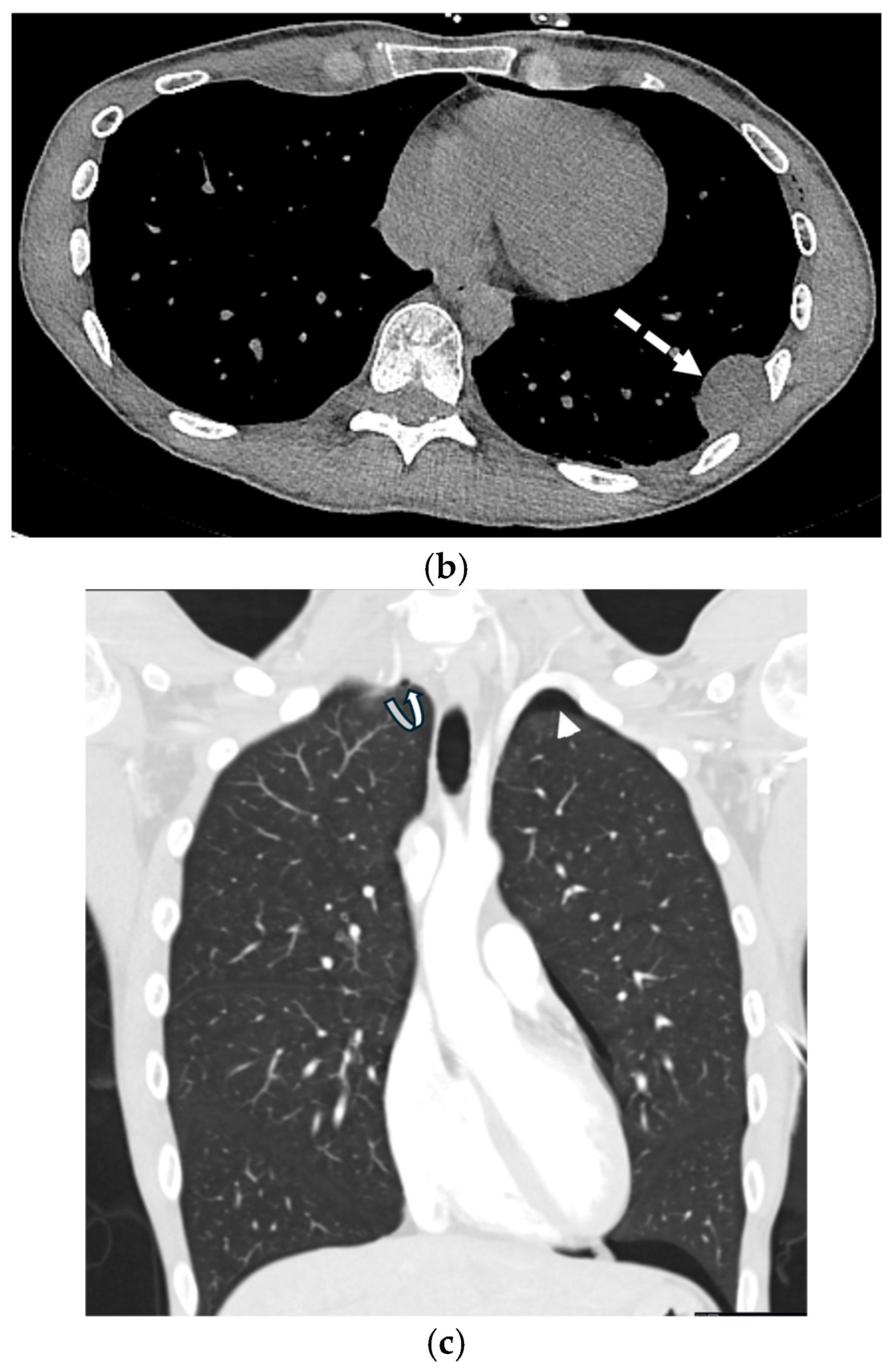 Spontaneous Pneumothorax: A Review of Underlying Etiologies and ...