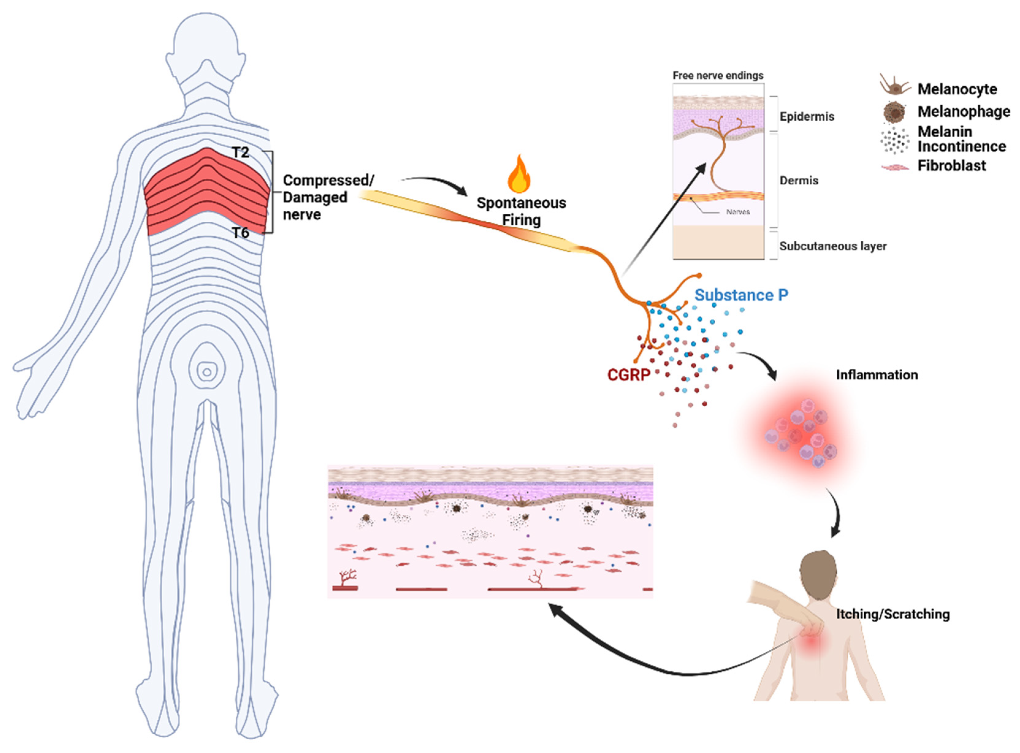 Botulinum Toxin Treatment of Notalgia Paresthetica—A Critical Review ...