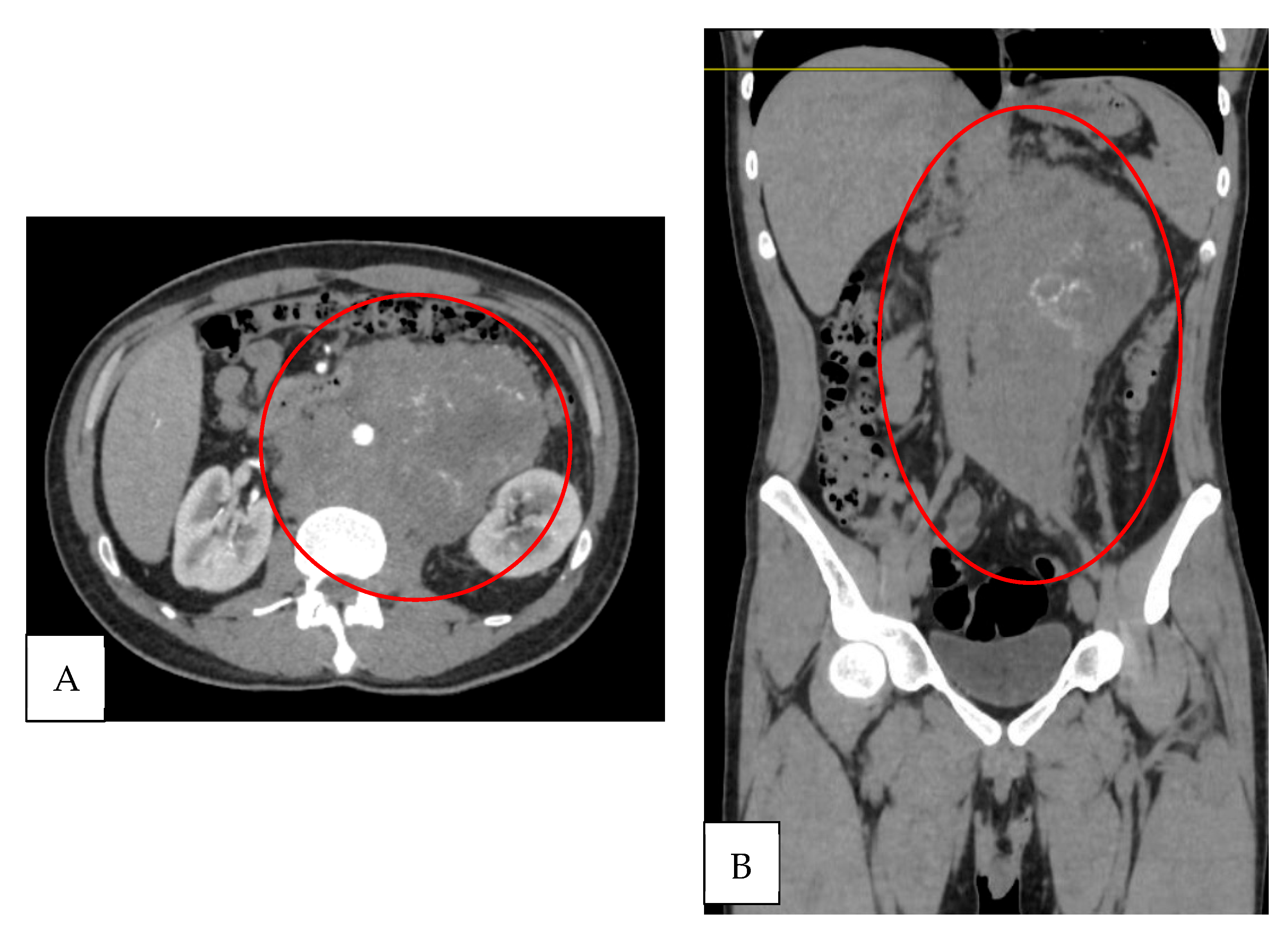 Retroperitoneal Metastasis of a Primary Testicular Seminoma with ...