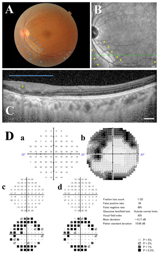 Bilateral Perivascular Chorioretinal Atrophy Resembling Pigmented ...
