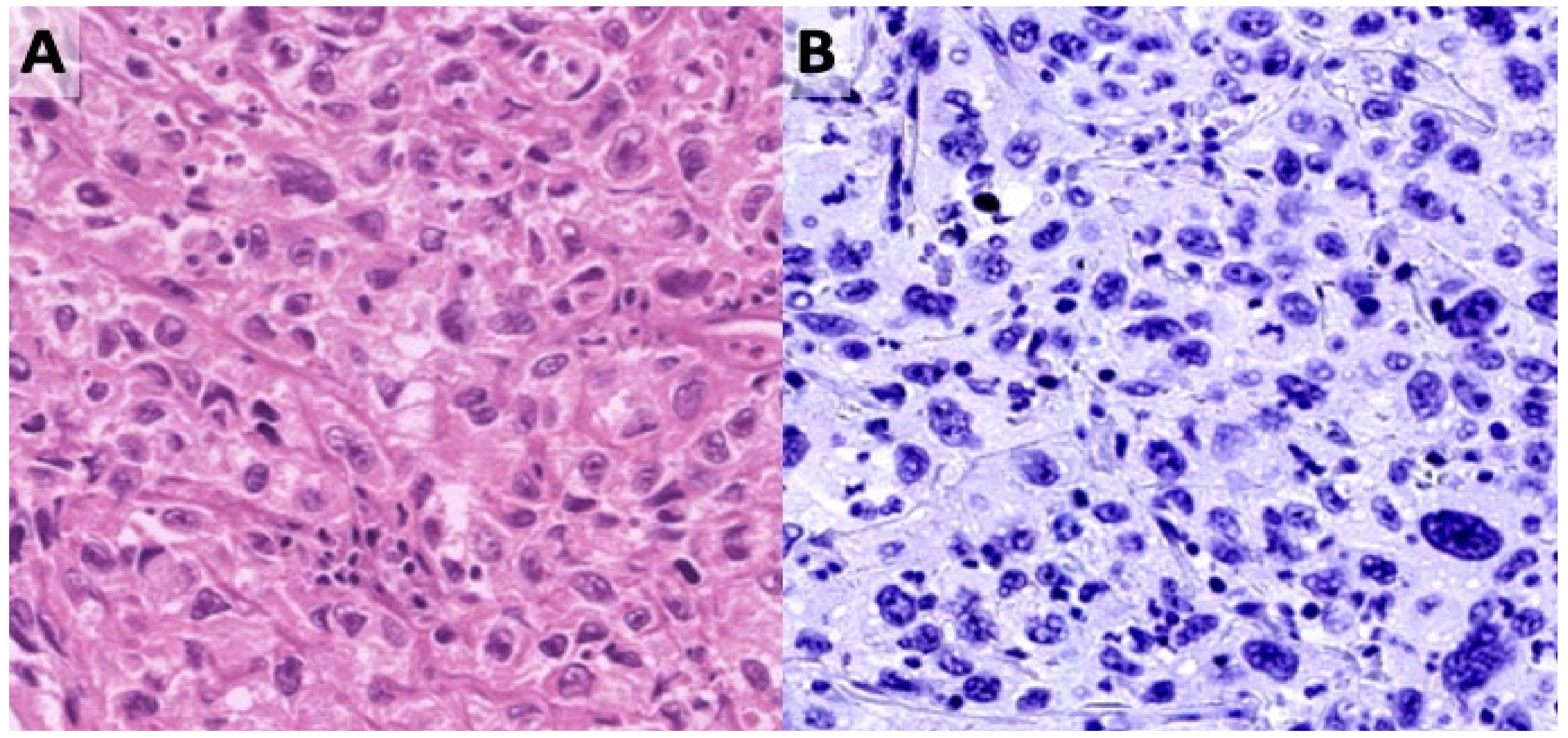 Viruses Free Full Text Reactivation Of BK Polyomavirus In Urine Viruses Free Full Text Reactivation Of BK Polyomavirus In Urine
