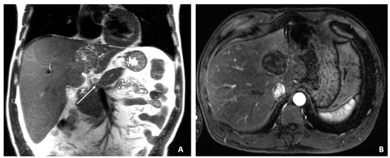 Alpha-Fetoprotein (AFP) and AFP-L3 Is Most Useful in Detection of ...